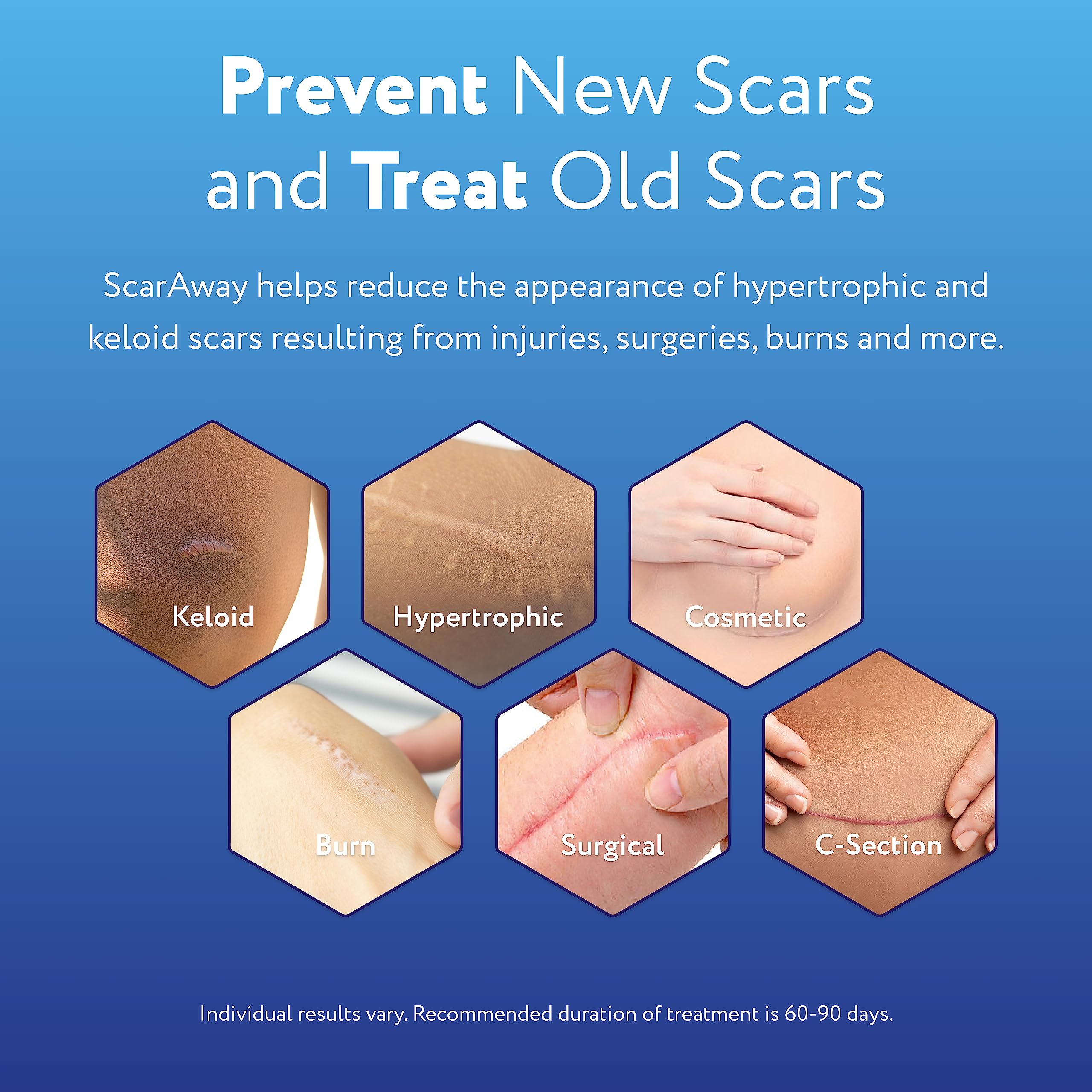 Hypertrophic Burn Scar