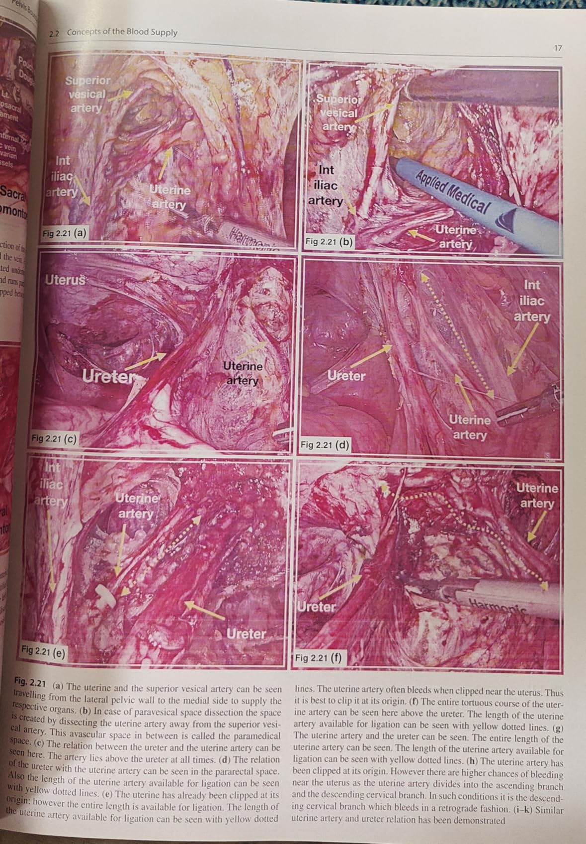 Buy LAPAROSCOPIC PELVIC ANATOMY IN FEMALES APPLIED SURGICAL PRINCIPLES ...