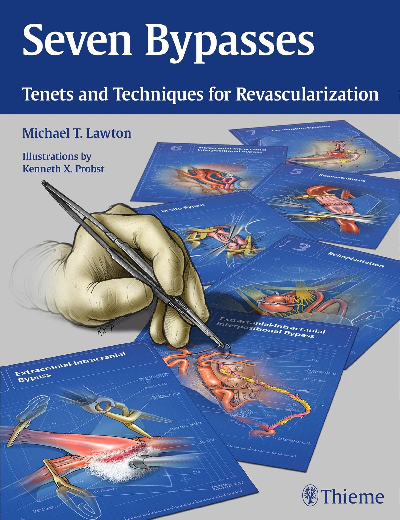 Seven Bypasses: Tenets and Techniques for Revascularization ...