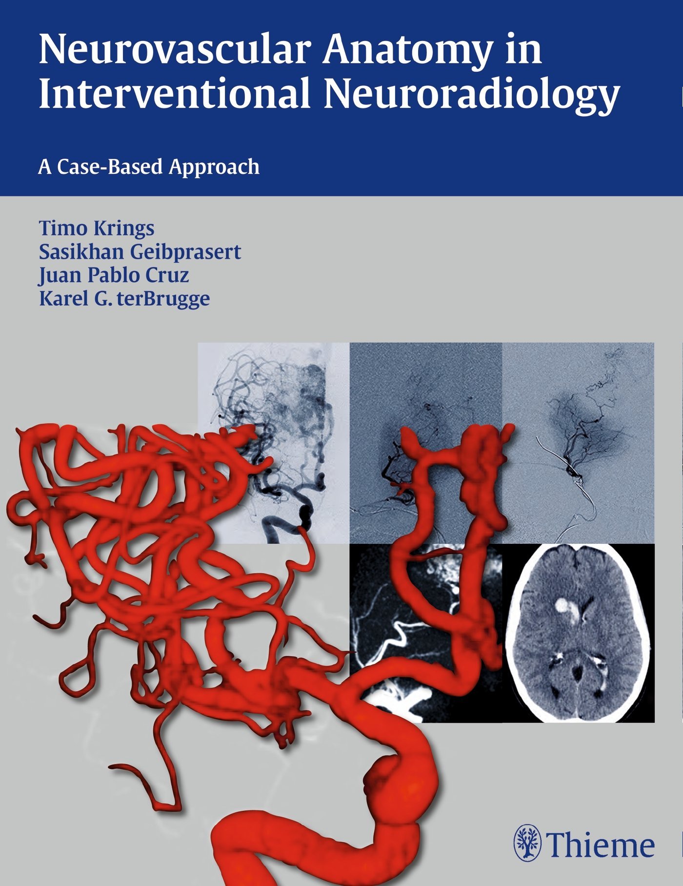 Neurovascular Anatomy in Interventional Neuroradiology: A Case-Based ...