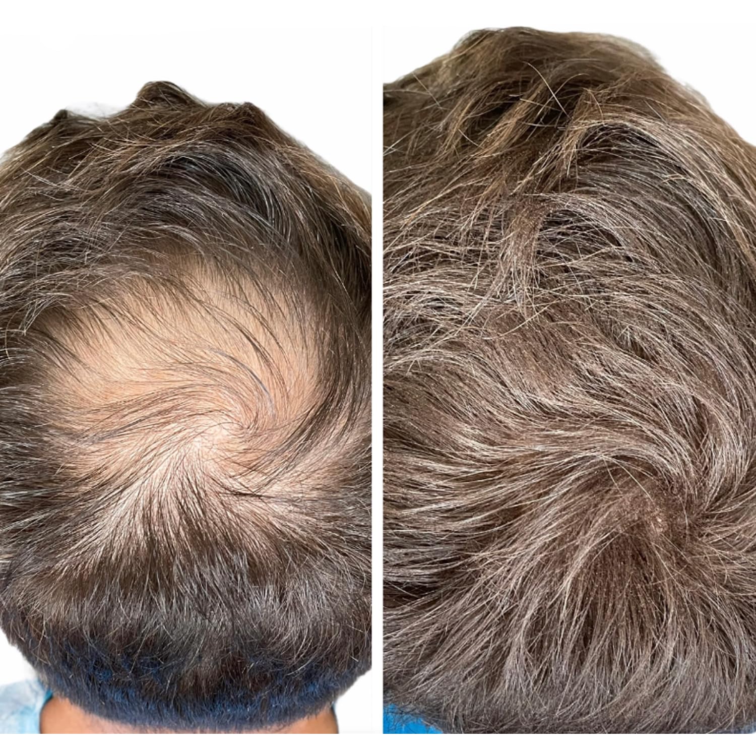 Amazon.com : Voloria Bald Spot Hair Patch Toupee for Men 3.15x3 ...