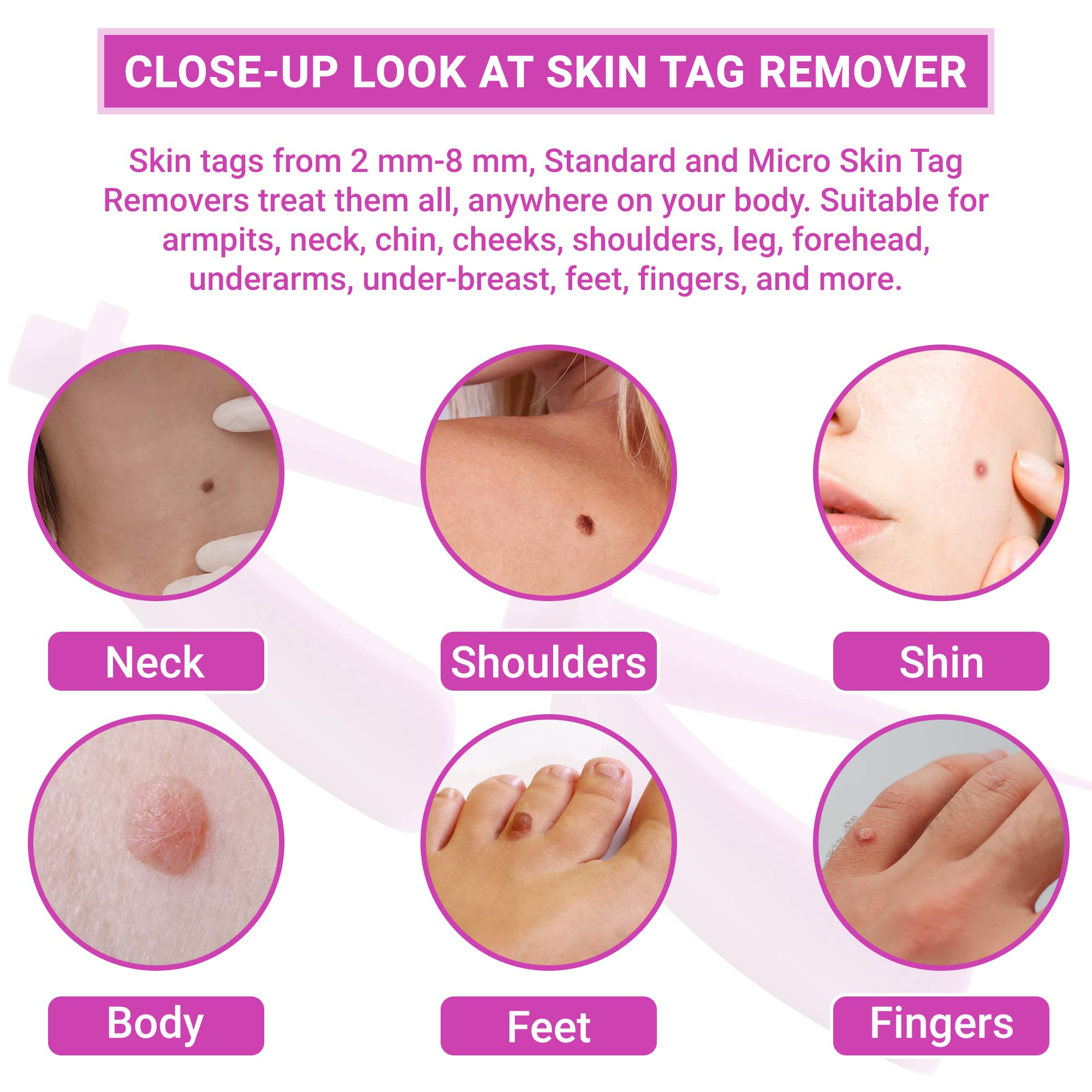 Buy Skin Tag Removal Kit, Small & Standard Skin Tag Remover Device, 36 ...