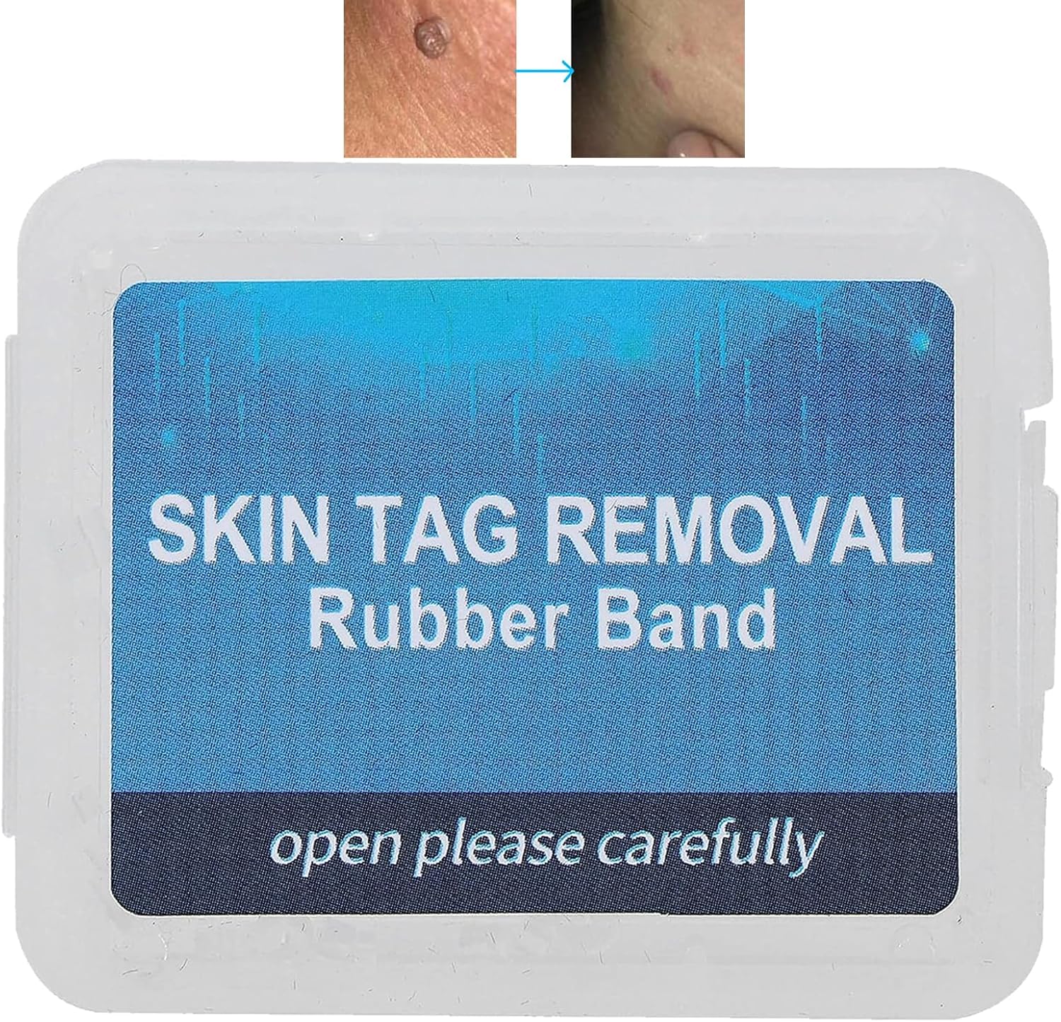 Skin Tag Removal Rubber Bands,Skin Tag Removal,Skin Marks Remover ...