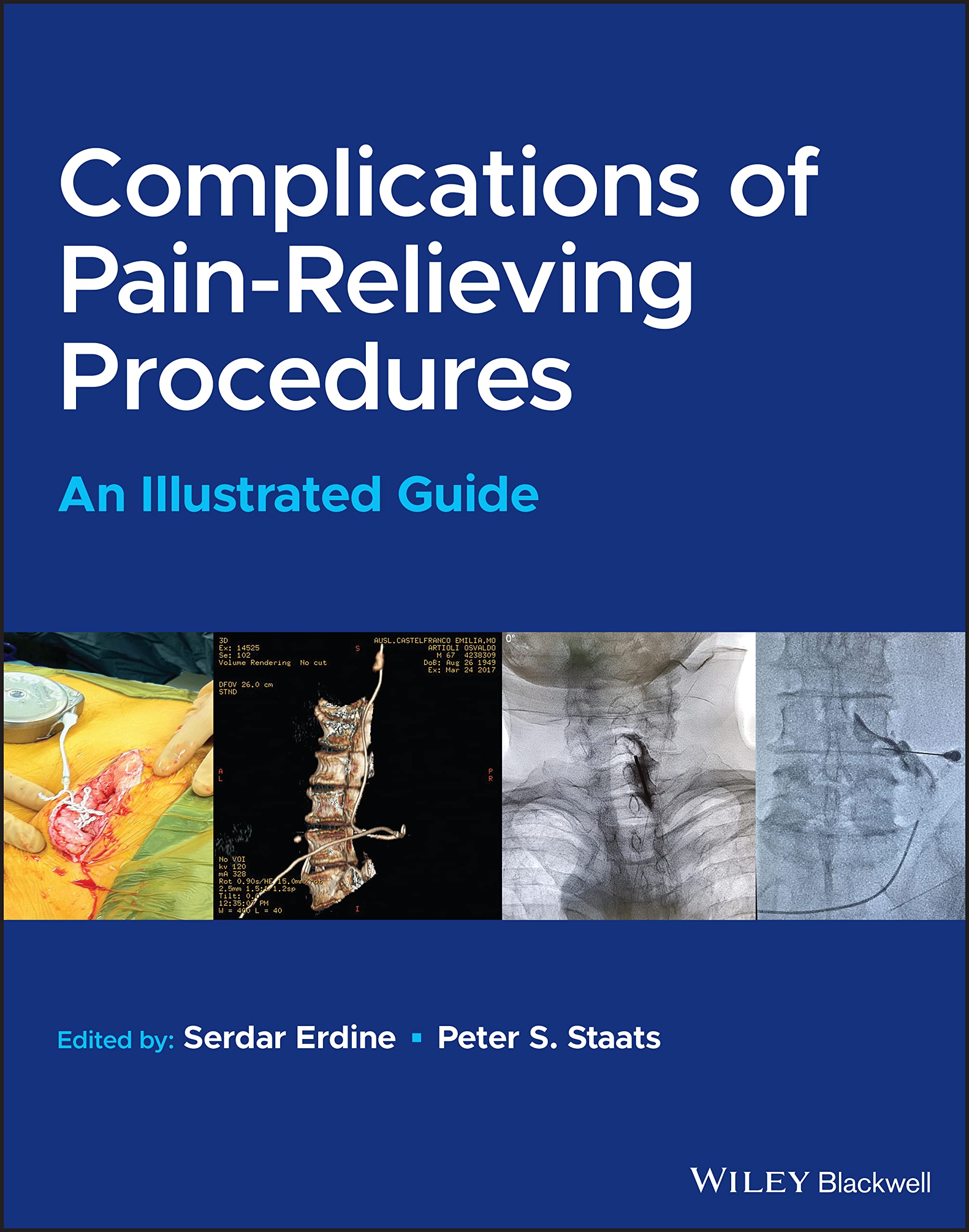 Complications of Pain-Relieving Procedures: An Illustrated Guide ...