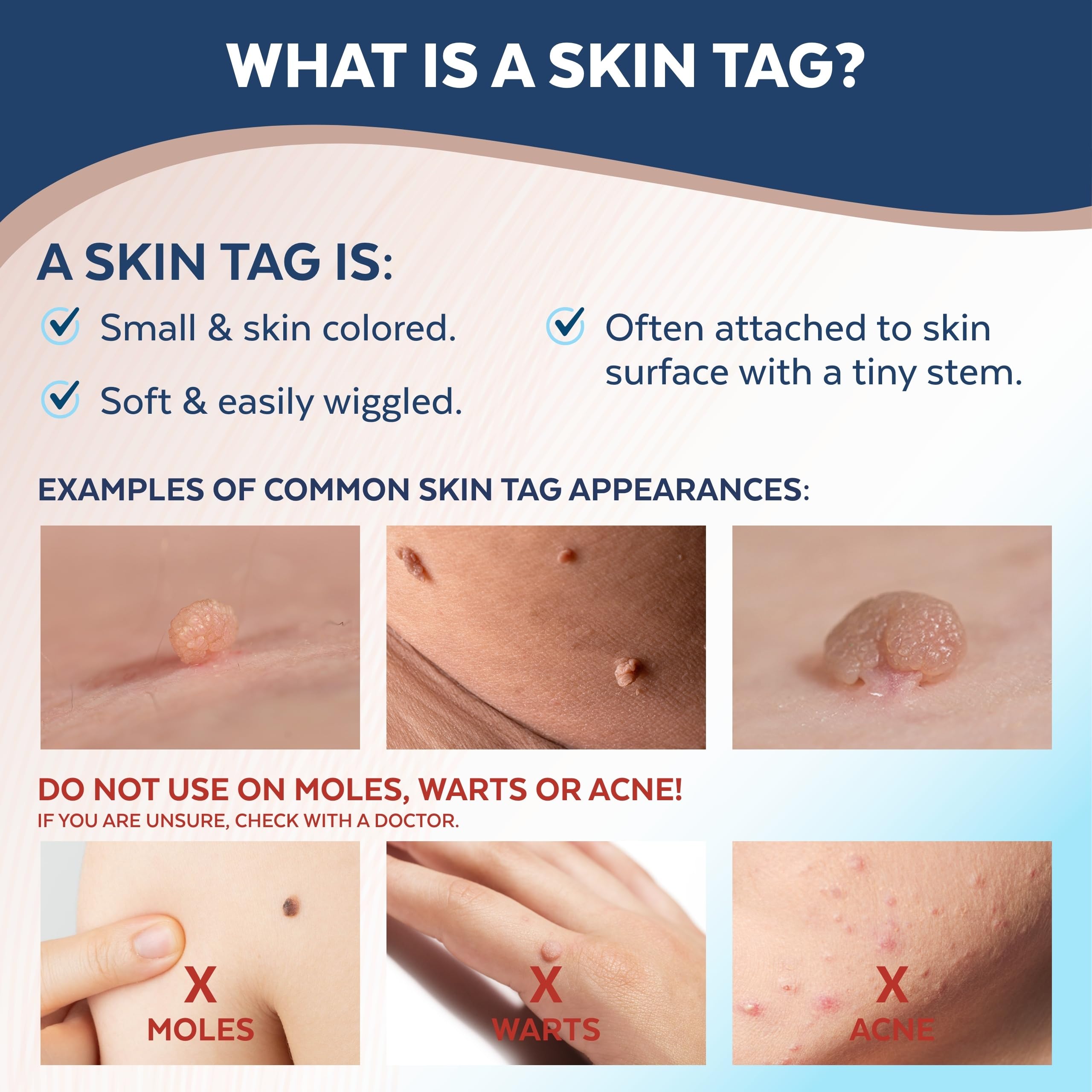 Skin Tags Skin Specialist Richmond | Advanced Skincare & Facials