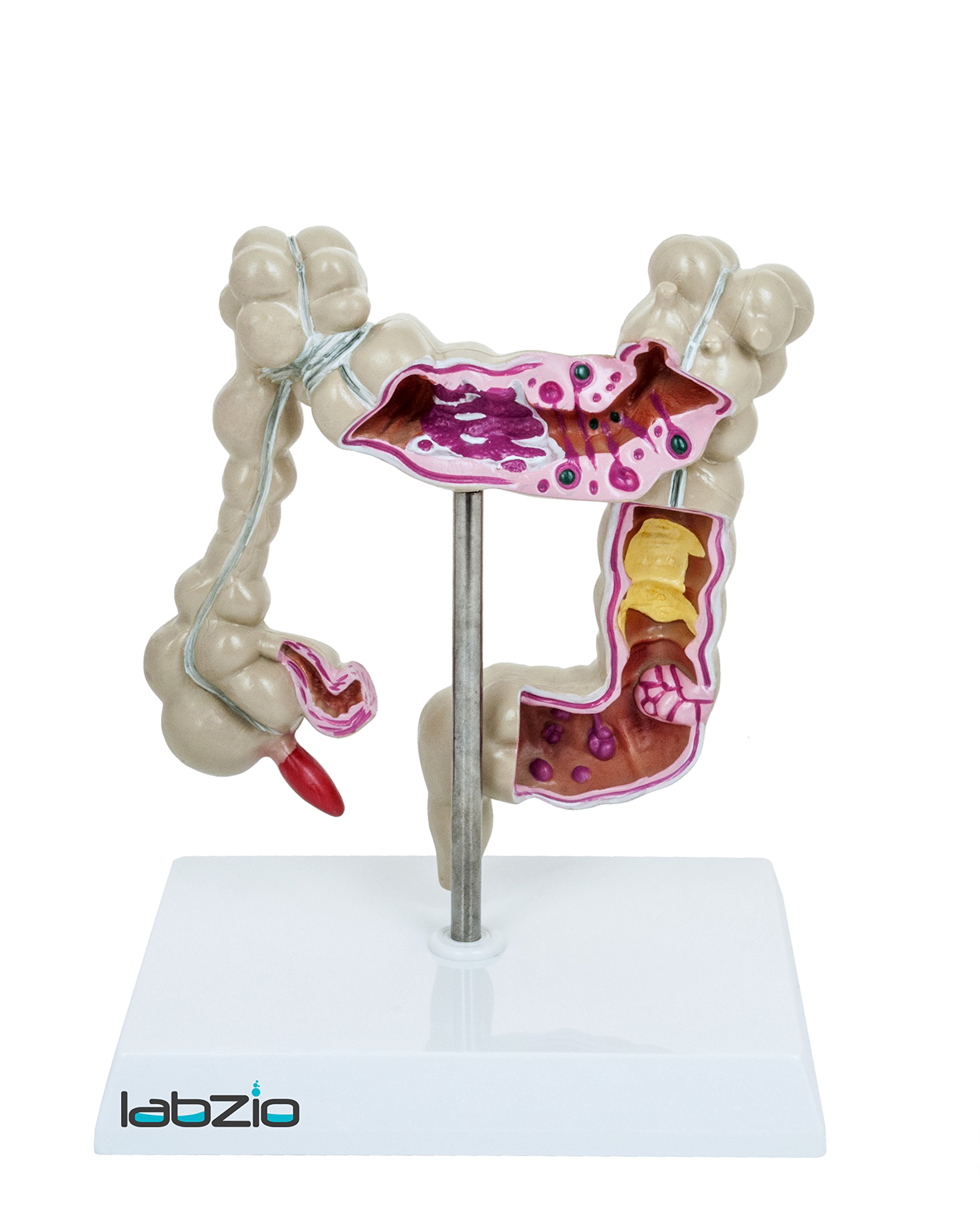 Buy Labzio - Medical Anatomical Human Colon Diseased (Large Intestine ...