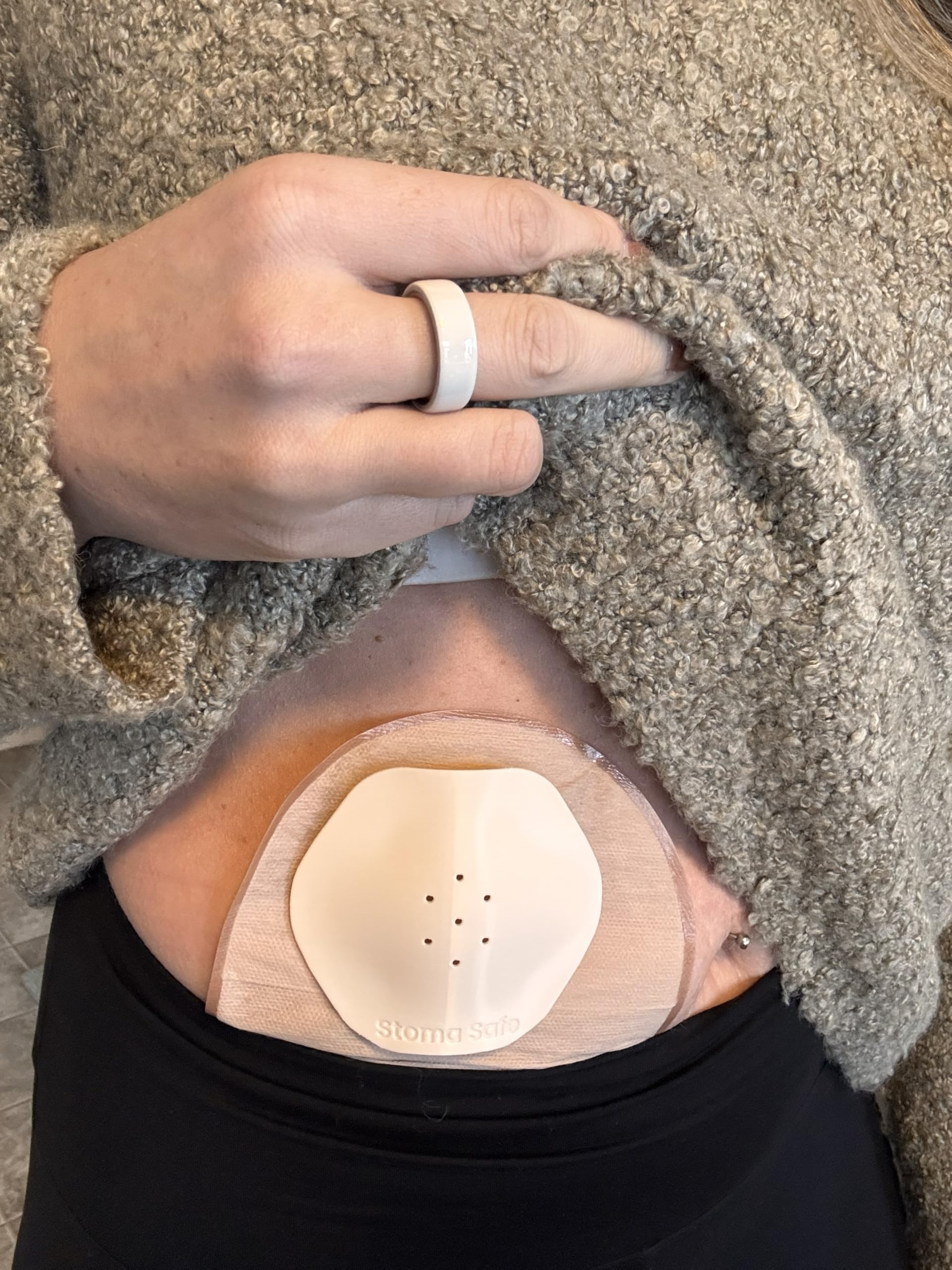 What Is A Stoma Guard