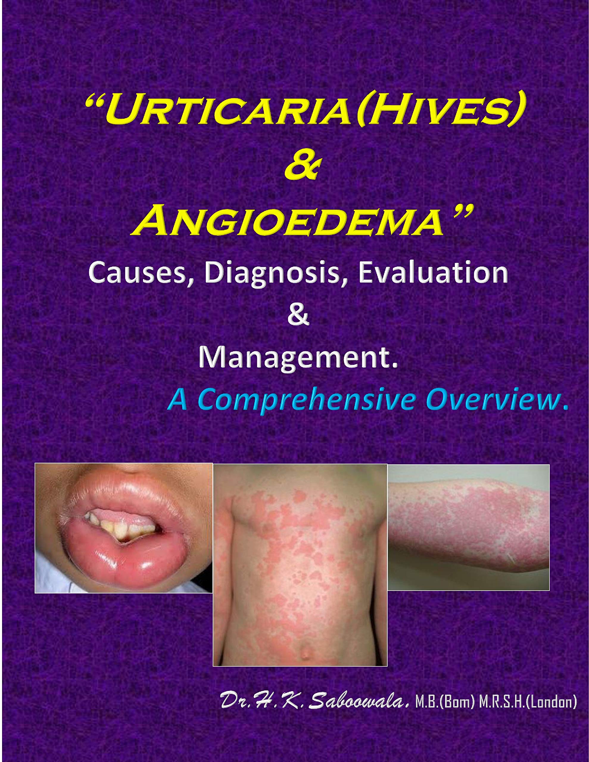 Buy “Urticaria (Hives) & Angioedema”-Causes, Diagnosis, Evaluation ...