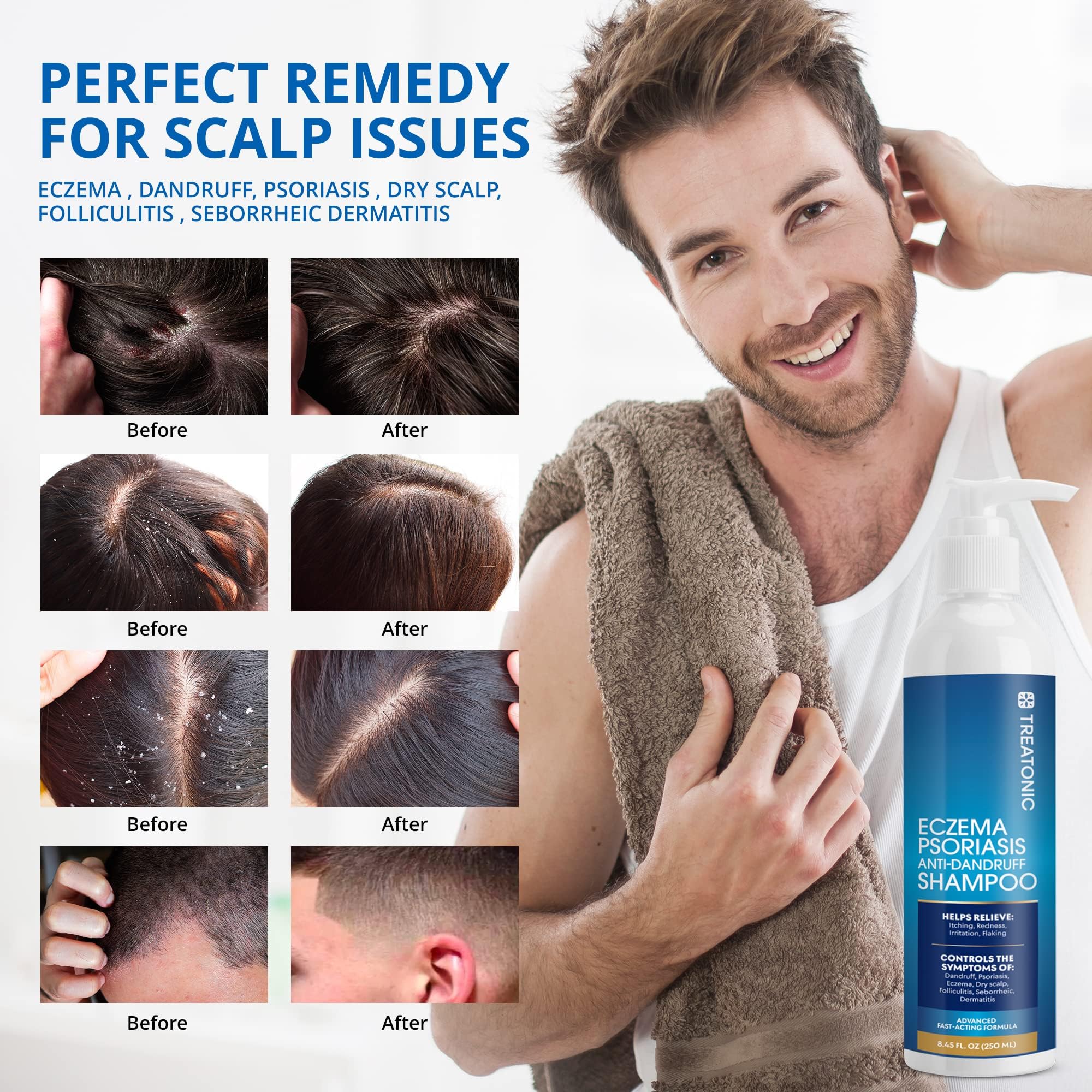 Snapklik.com : Eczema Shampoo Psoriasis Shampoo: Seborrheic Dermatitis ...