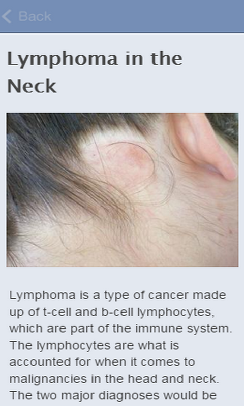 Lymphoma Behind Ear Symptoms