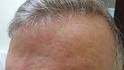 Figure From Resistant Scalp Folliculitis Secondary To, 60% OFF