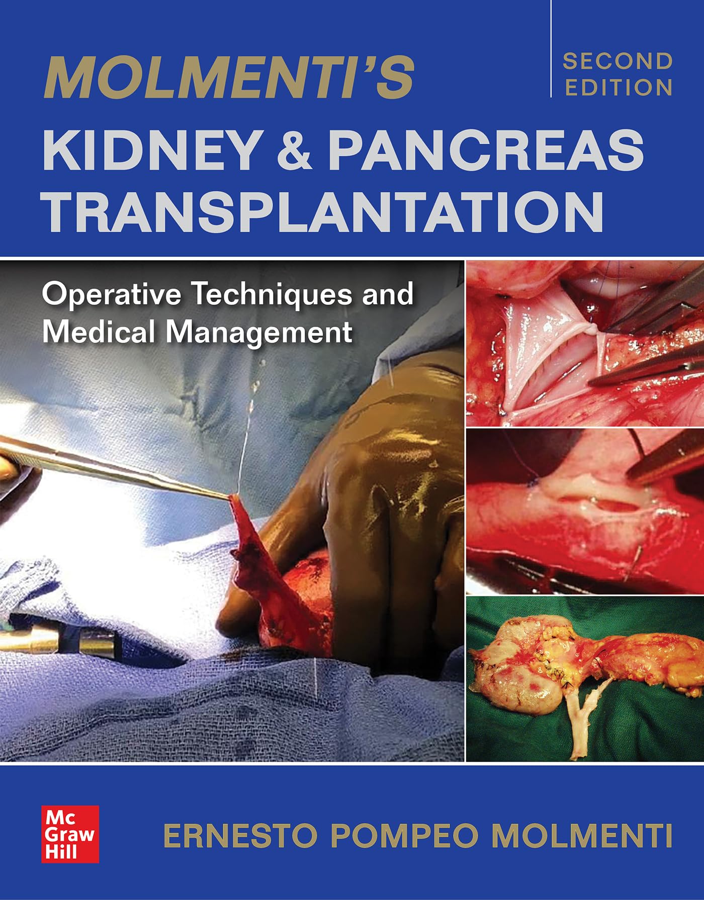 Molmenti's Kidney and Pancreas Transplantation: Operative Techniques ...