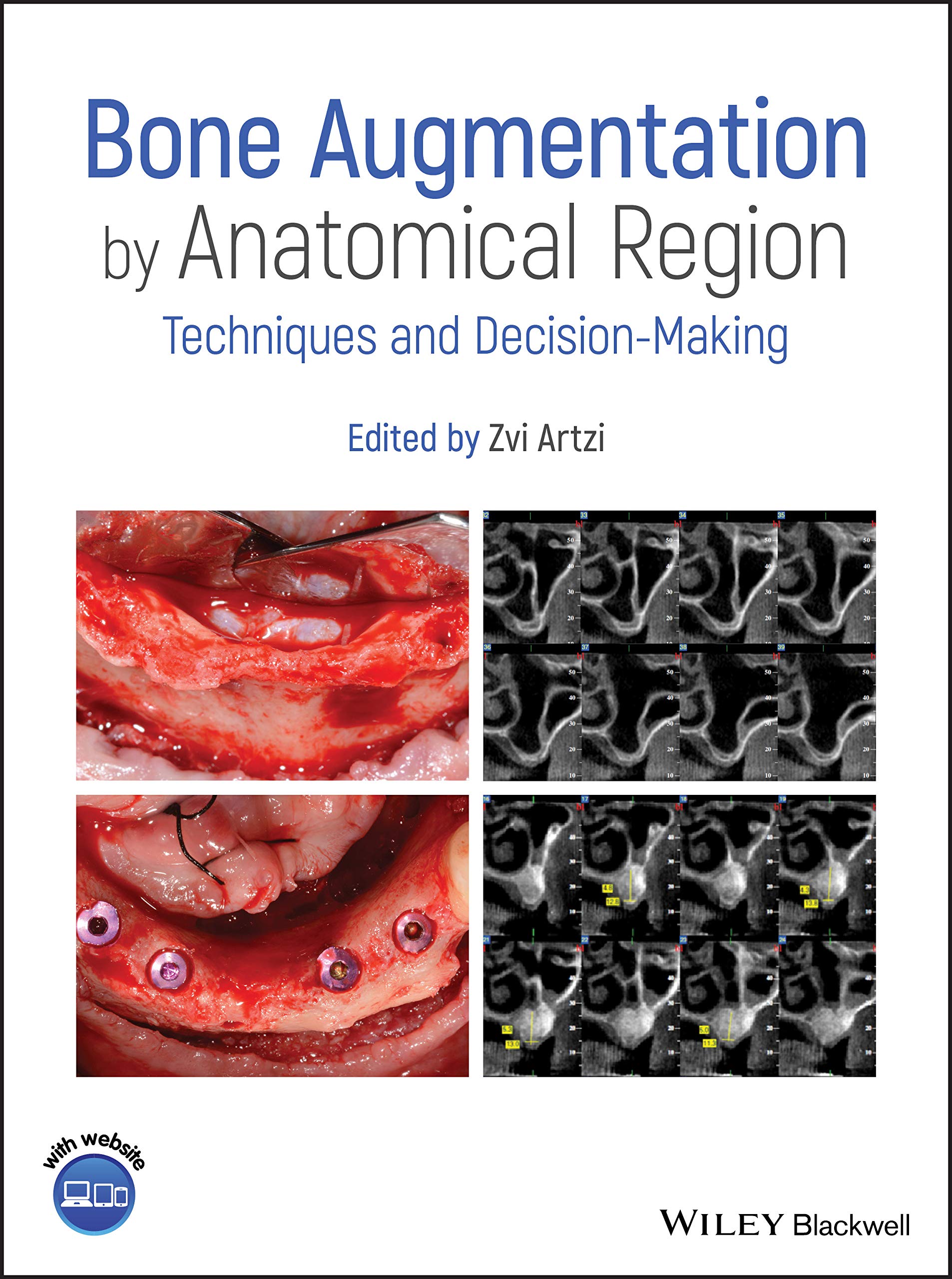 Bone Augmentation by Anatomical Region: Techniques and Decision-Making ...