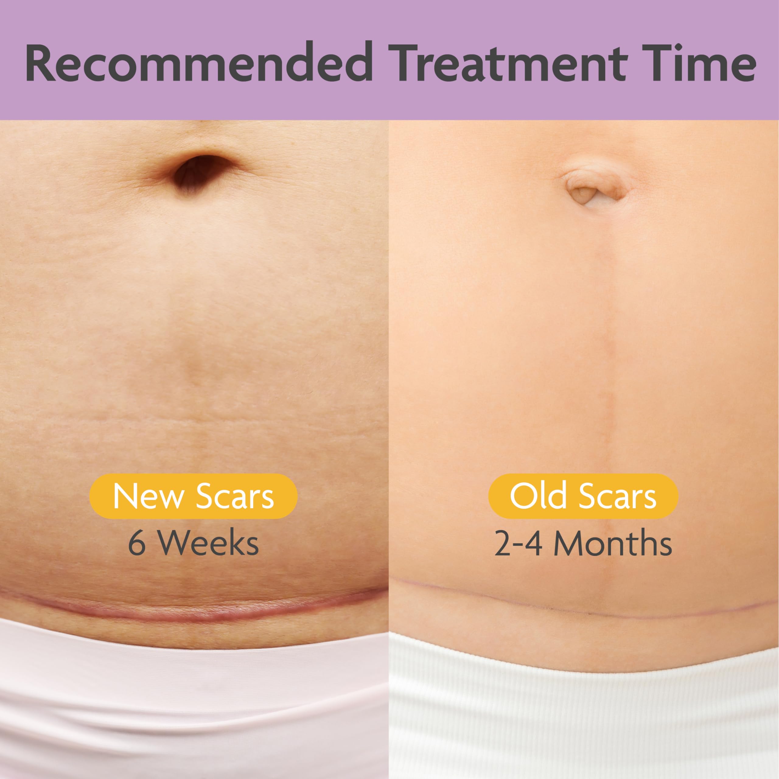 2 C Section Scars Is My C Section Scar Healing Well? » One On One