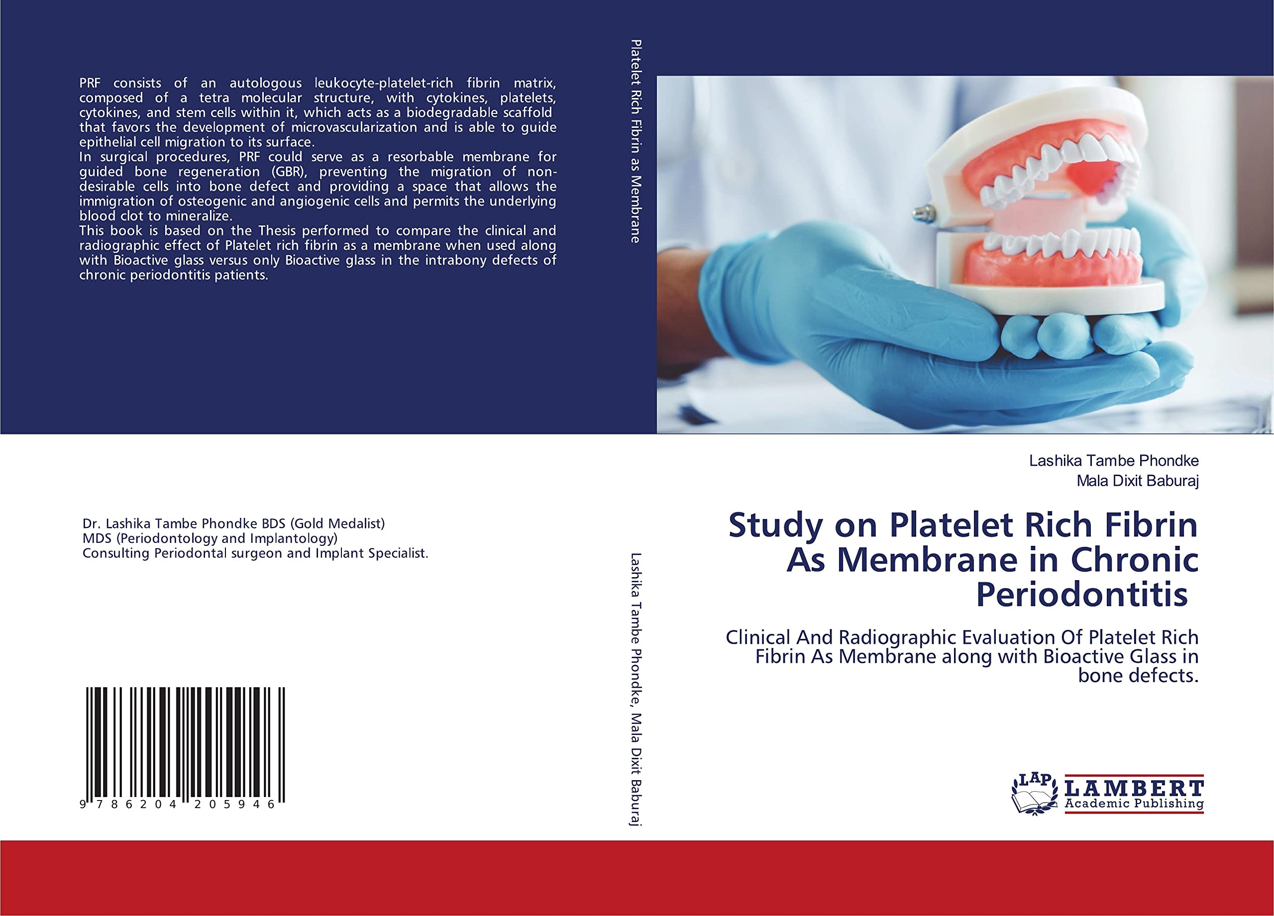 Study on Platelet Rich Fibrin As Membrane in Chronic Periodontitis ...