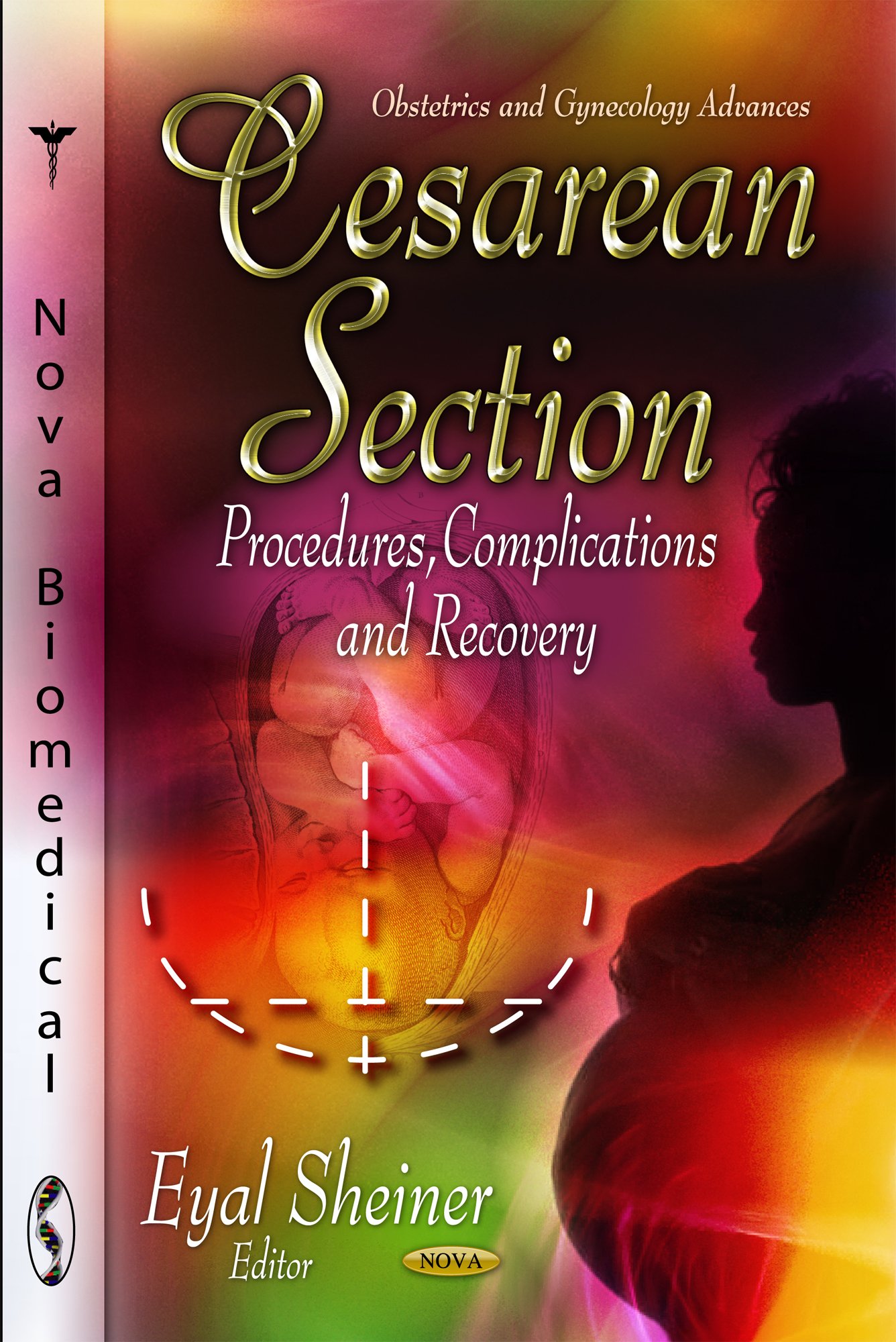 Cesarean Section: Procedures, Complications and Recovery (Obstetrics ...