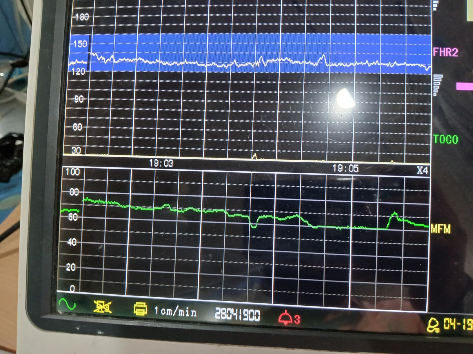 E-Medical Fetal Monitor Paper for BISTOS/EDAN/CTG Monitor (Pack of 5 ...