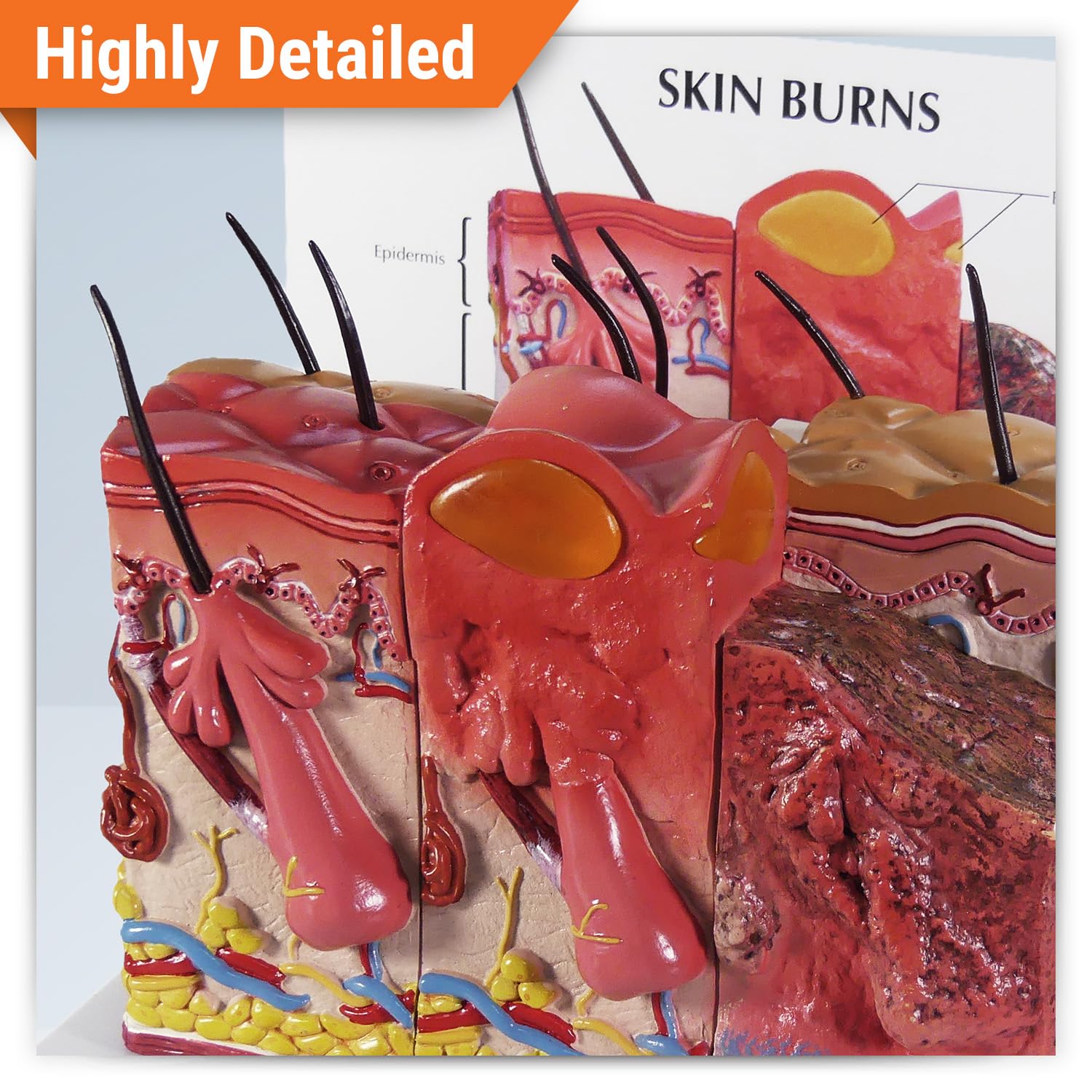 Snapklik.com : Skin Burn Model, Cross-Section Model Showing Normal And ...