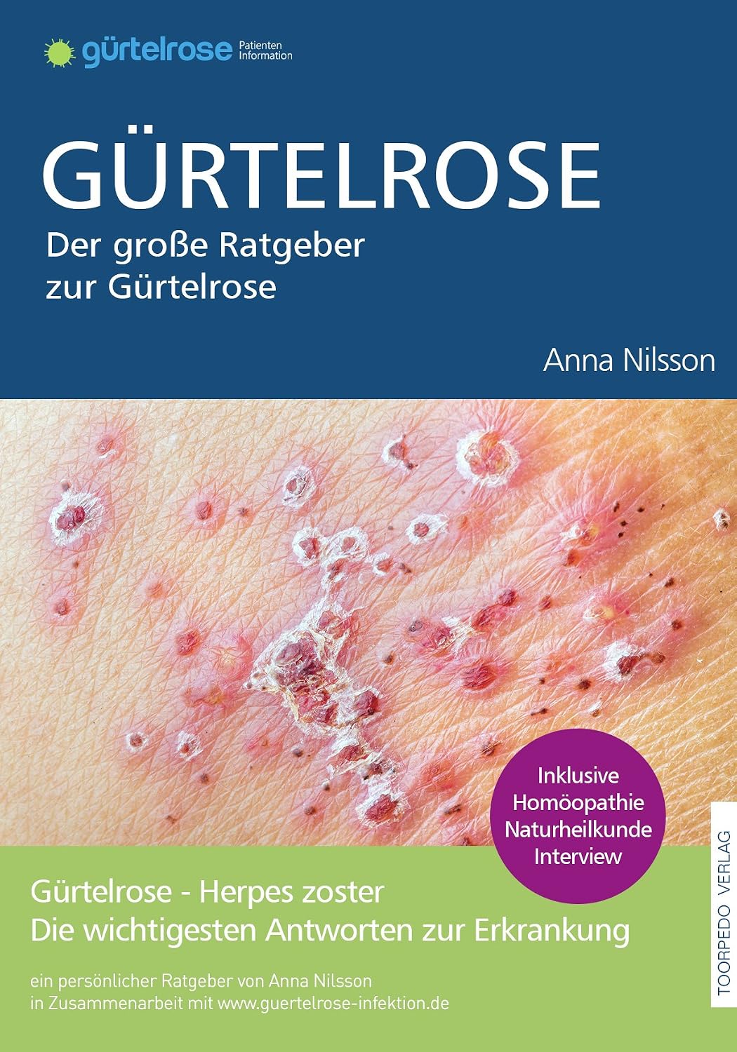 Wunderbar Therapie Bei Gurtelrose Bilder