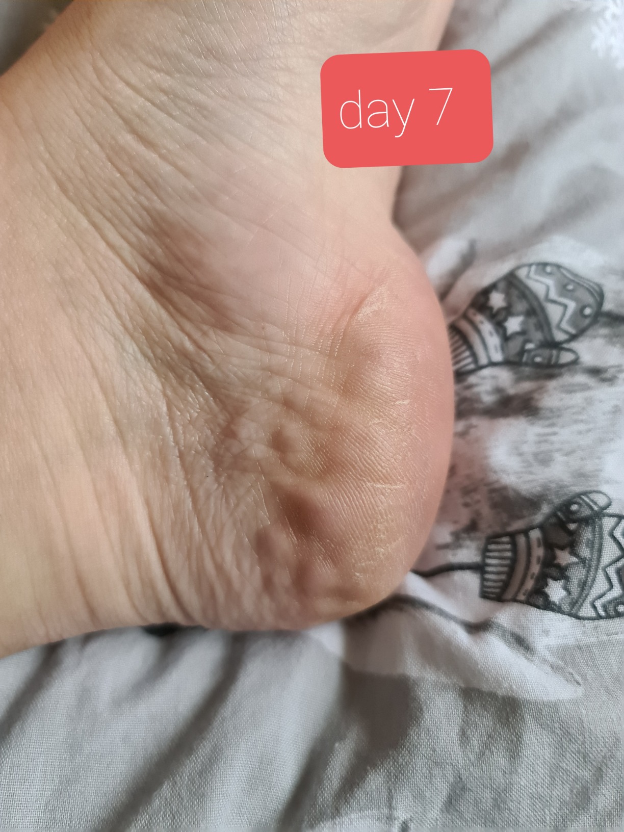 FOOTNESS Rough Skin & Callus Cream - Reduces Callused, Rough & Hard ...