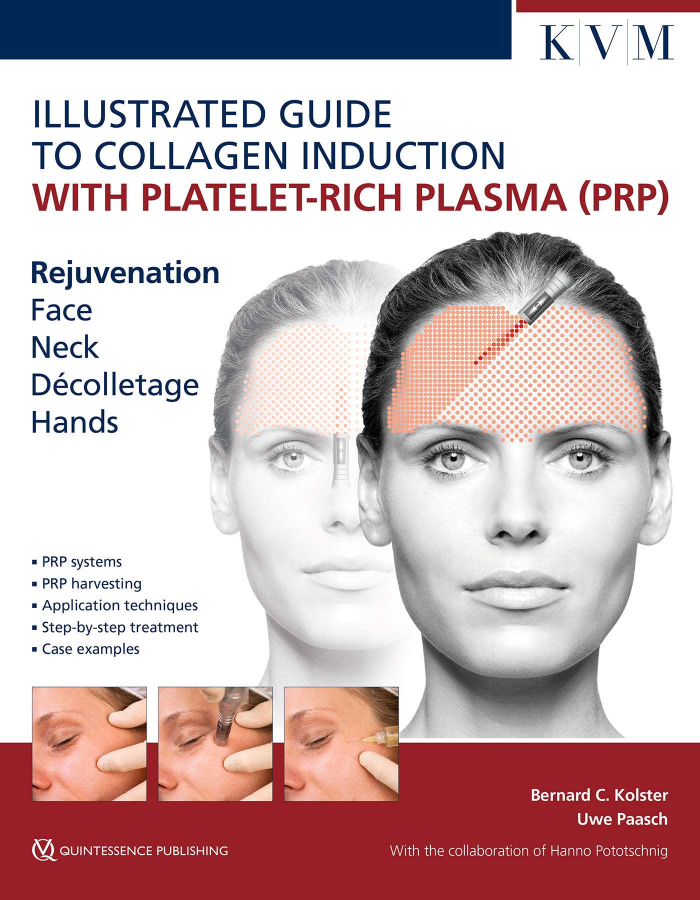Illustrated Guide to Collagen Induction With Platelet-rich Plasma ...