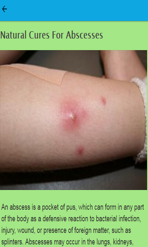 How To Treat An Abscess - App on the Amazon Appstore