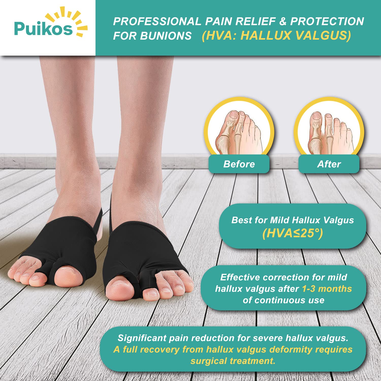 Puikos Bunion Splints Big Toe Straightener Bunion Relief Hallux Valgus ...