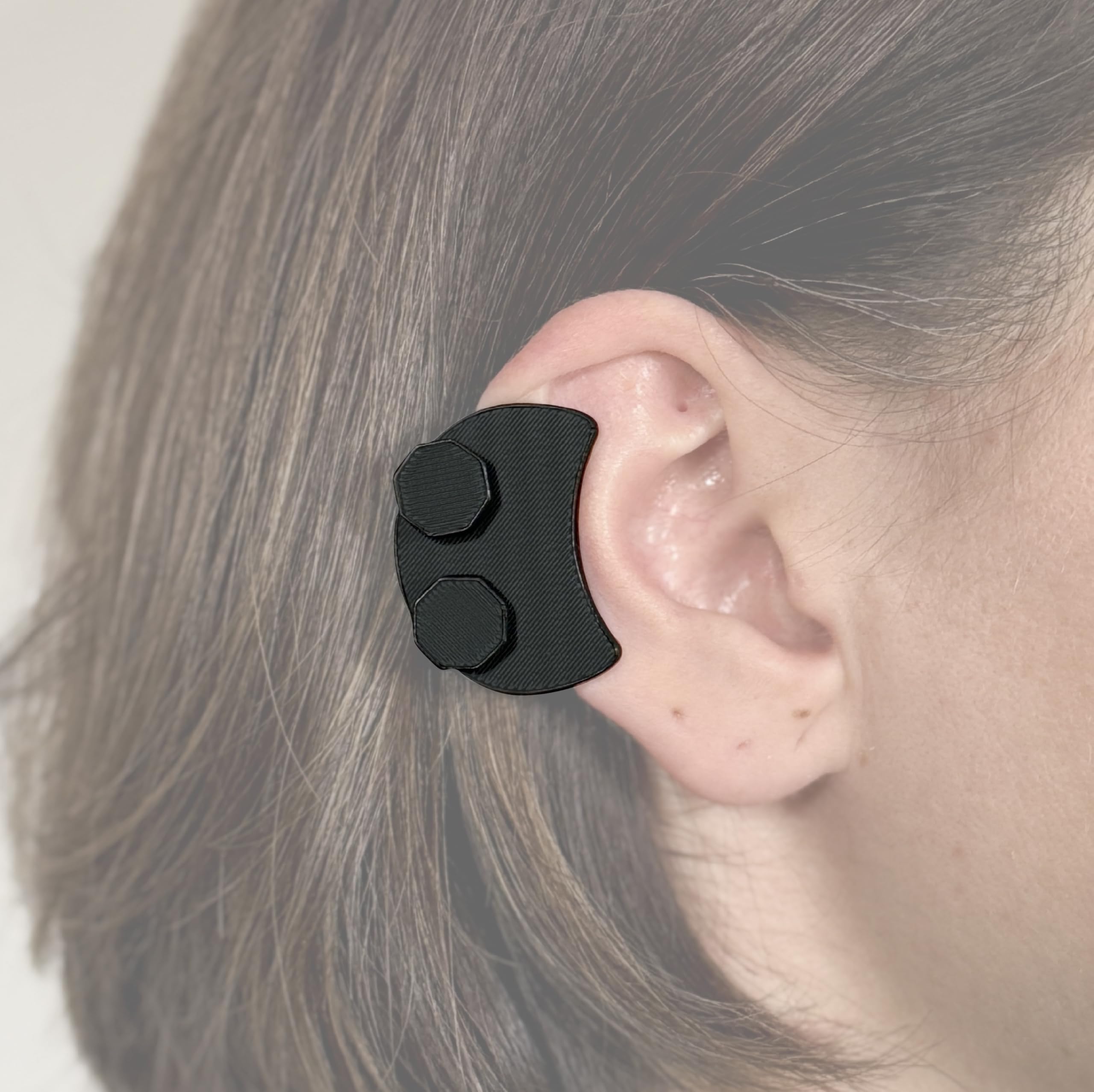 Earlobe Keloid Treatment