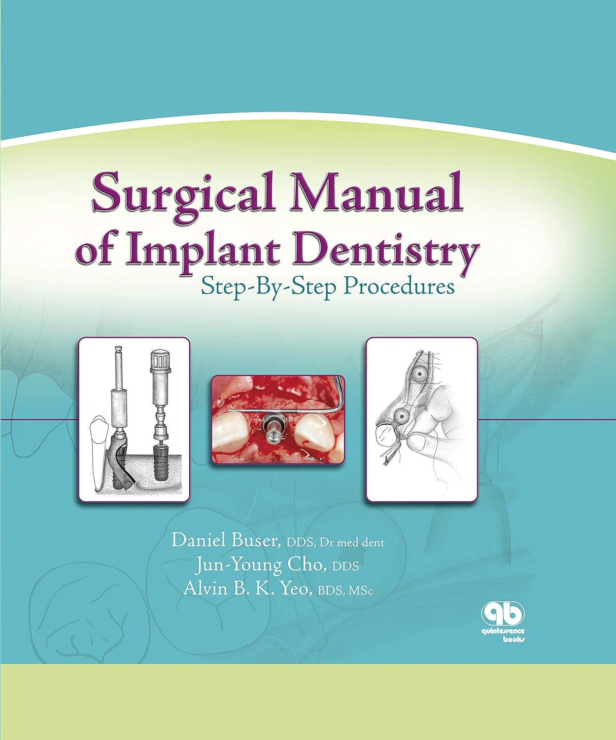 Surgical Manual of Implant Dentistry: Step-by-Step Procedures - Kindle ...