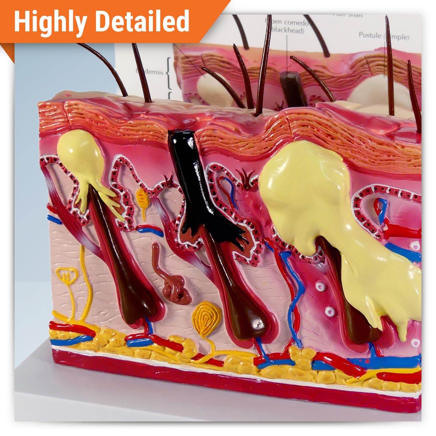 Snapklik.com : Skin Acne Model, Cross-Section Showing Normal And Common ...