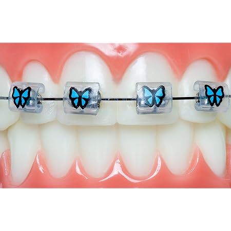 Amazon.com : Braces Wax Alternative Bracket Cover Bumper Orthodontic ...