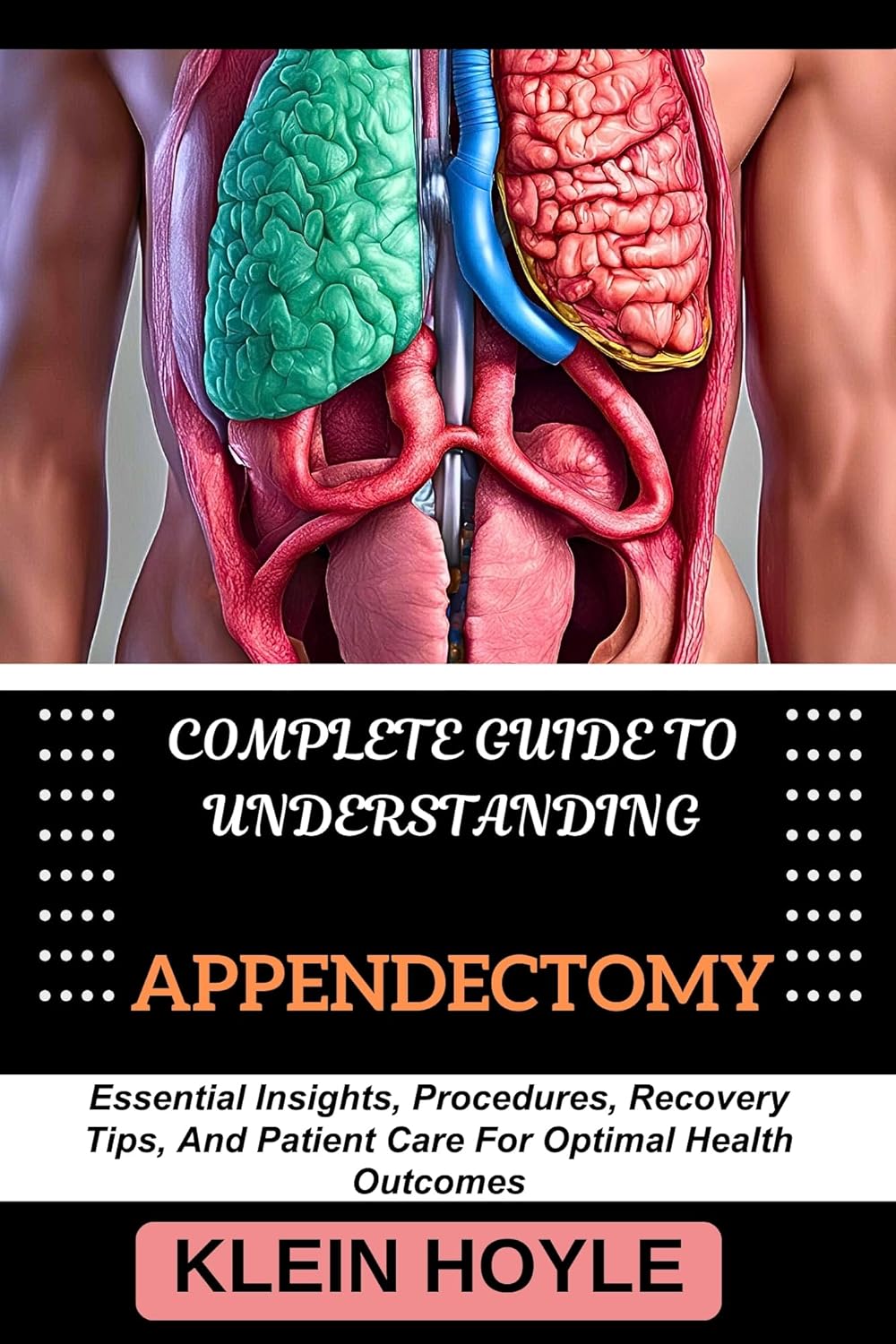 COMPLETE GUIDE TO UNDERSTANDING APPENDECTOMY: Essential Insights, Procedures, Recovery Tips, And ...