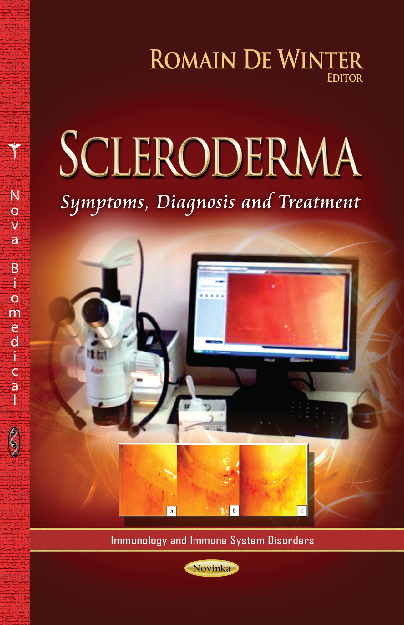 Scleroderma: Symptoms, Diagnosis and Treatment (Immunology and Immune ...