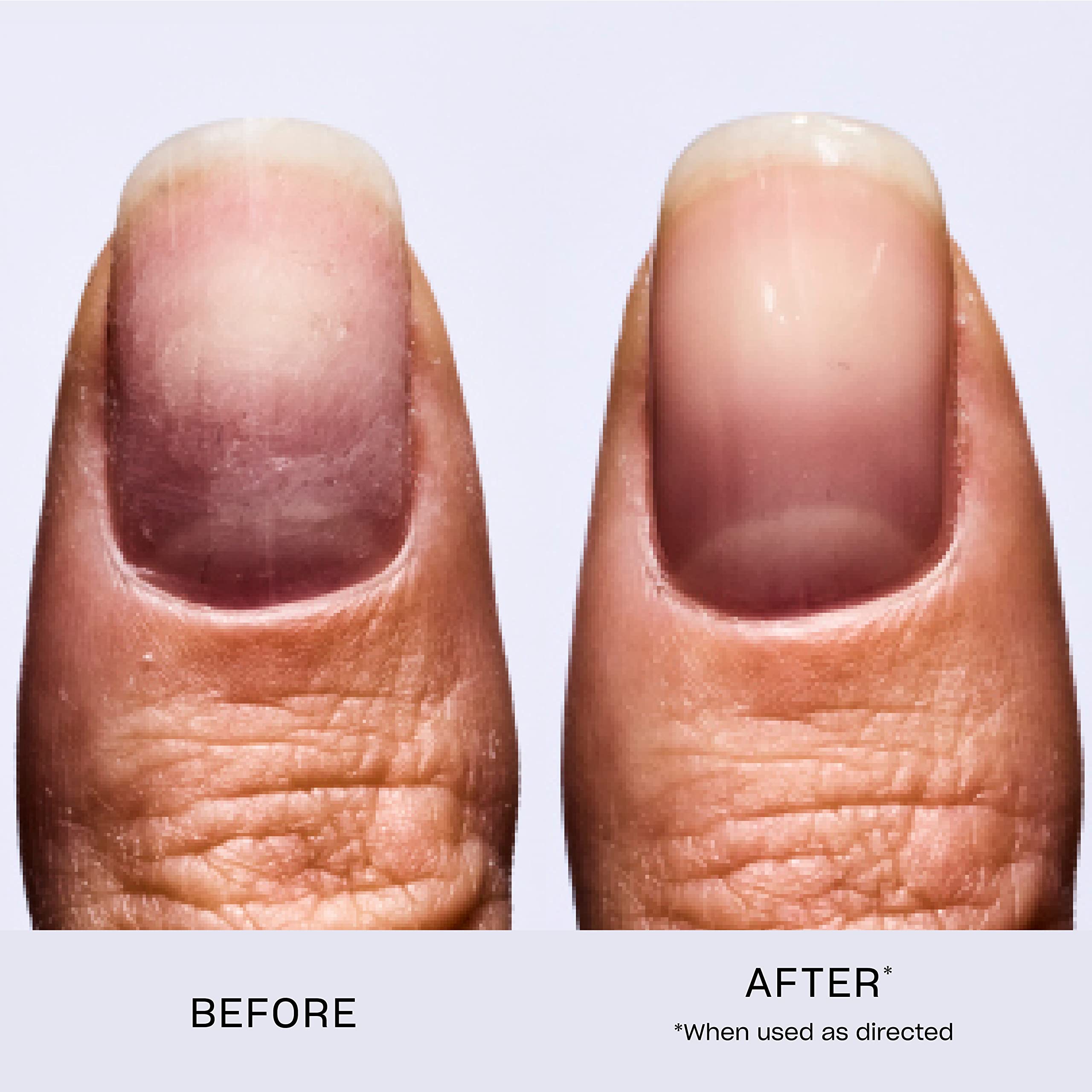 Fingernail Skin Peeling