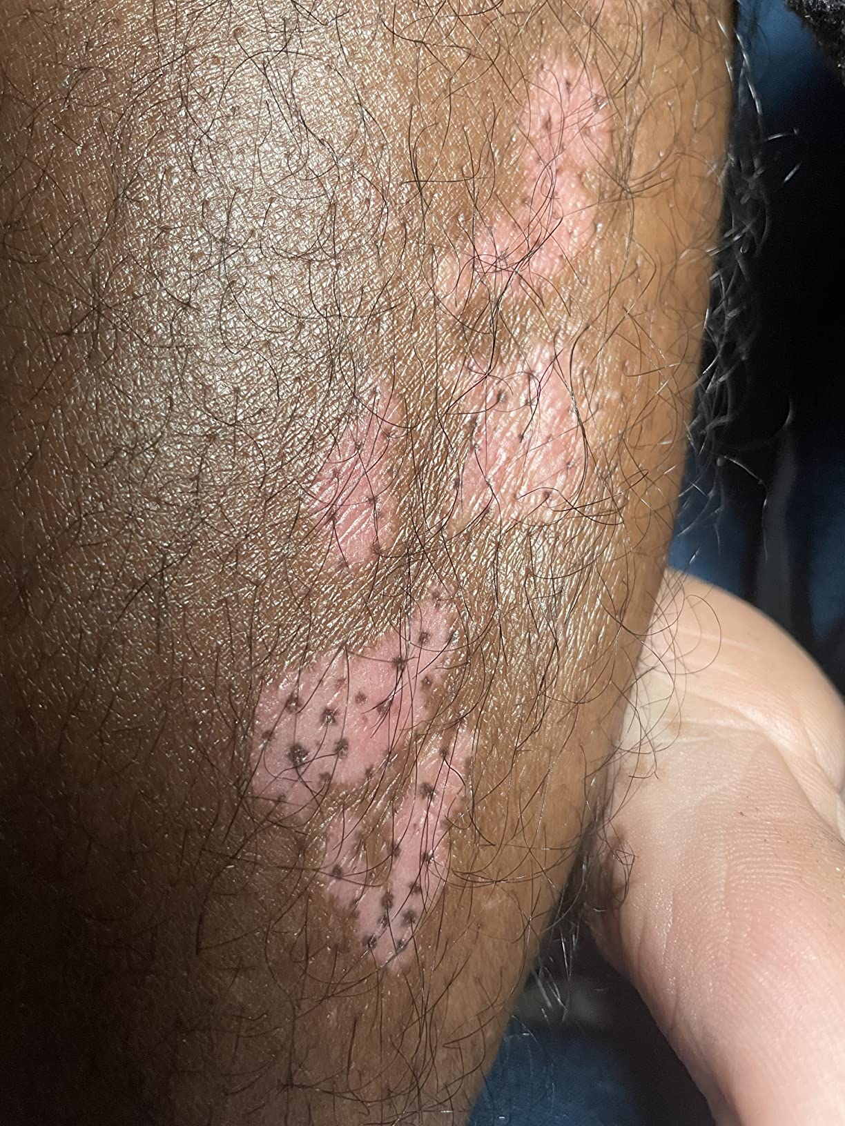 Lecor oil I Ayurvedic Medicine for Vitiligo I Leukoderma I Need to use ...