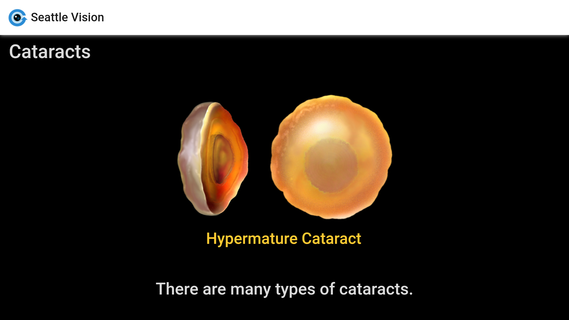 Eye GIFs - Ophthalmic & Eye Care Patient Education - App on Amazon Appstore