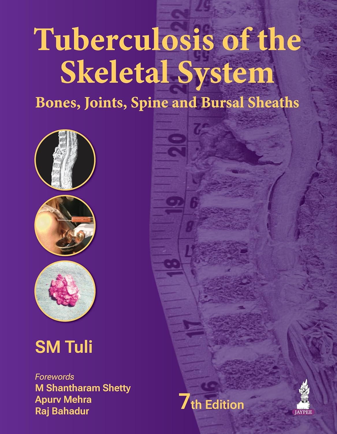 Amazon | Tuberculosis of the Skeletal System: Bones, Joints, Spine and ...