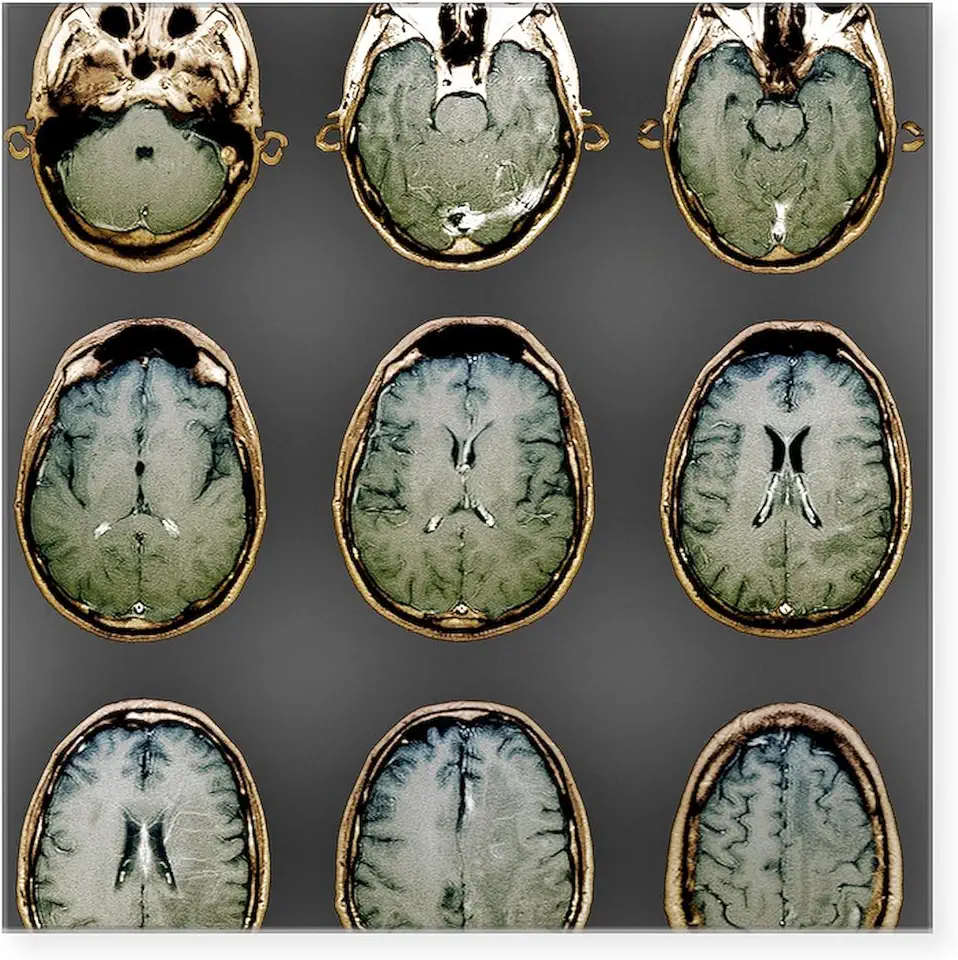Brain Scans: Uncovering Old Strokes And Their Secrets | MedShun
