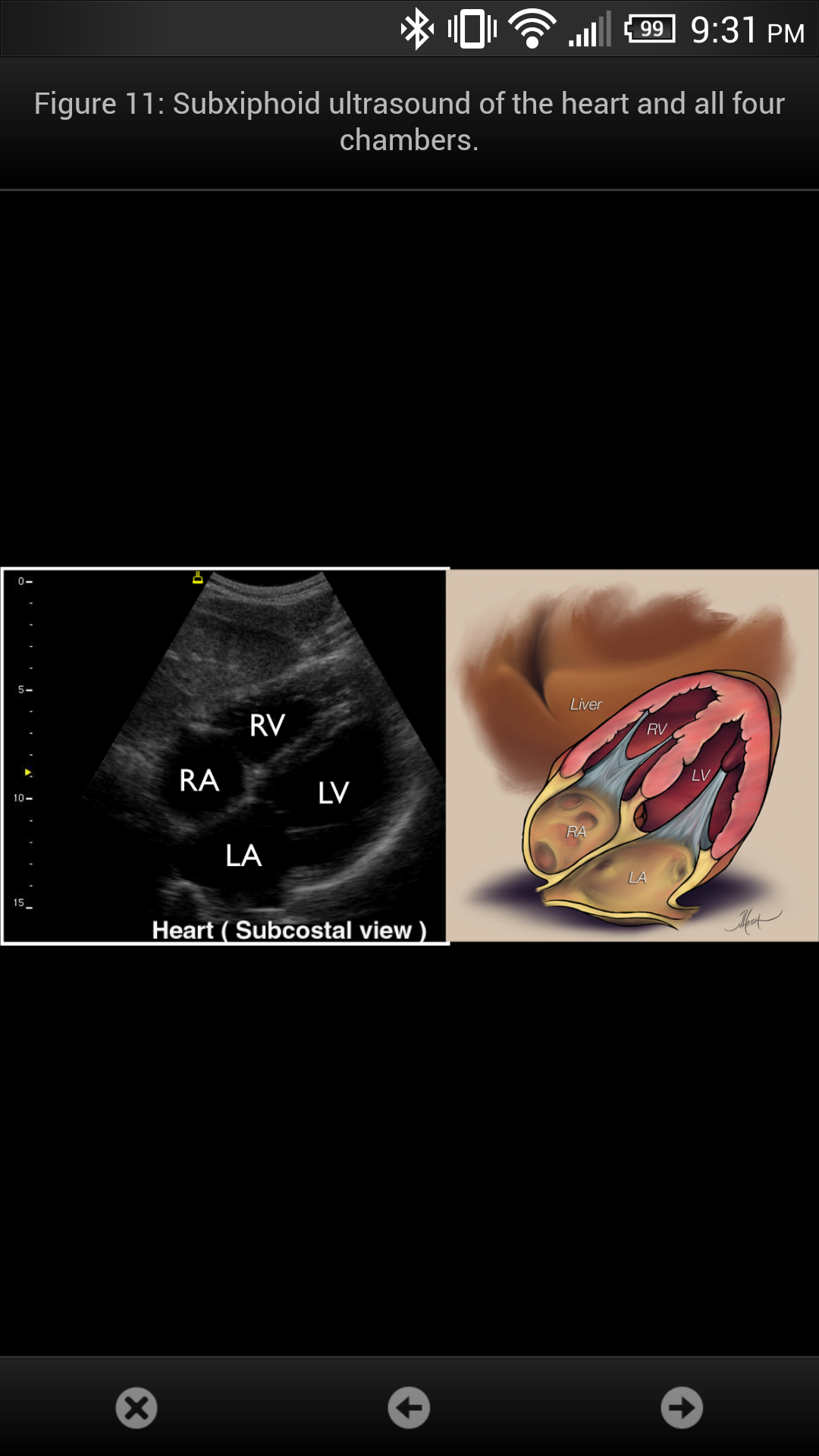 Subxiphoid Ultrasound