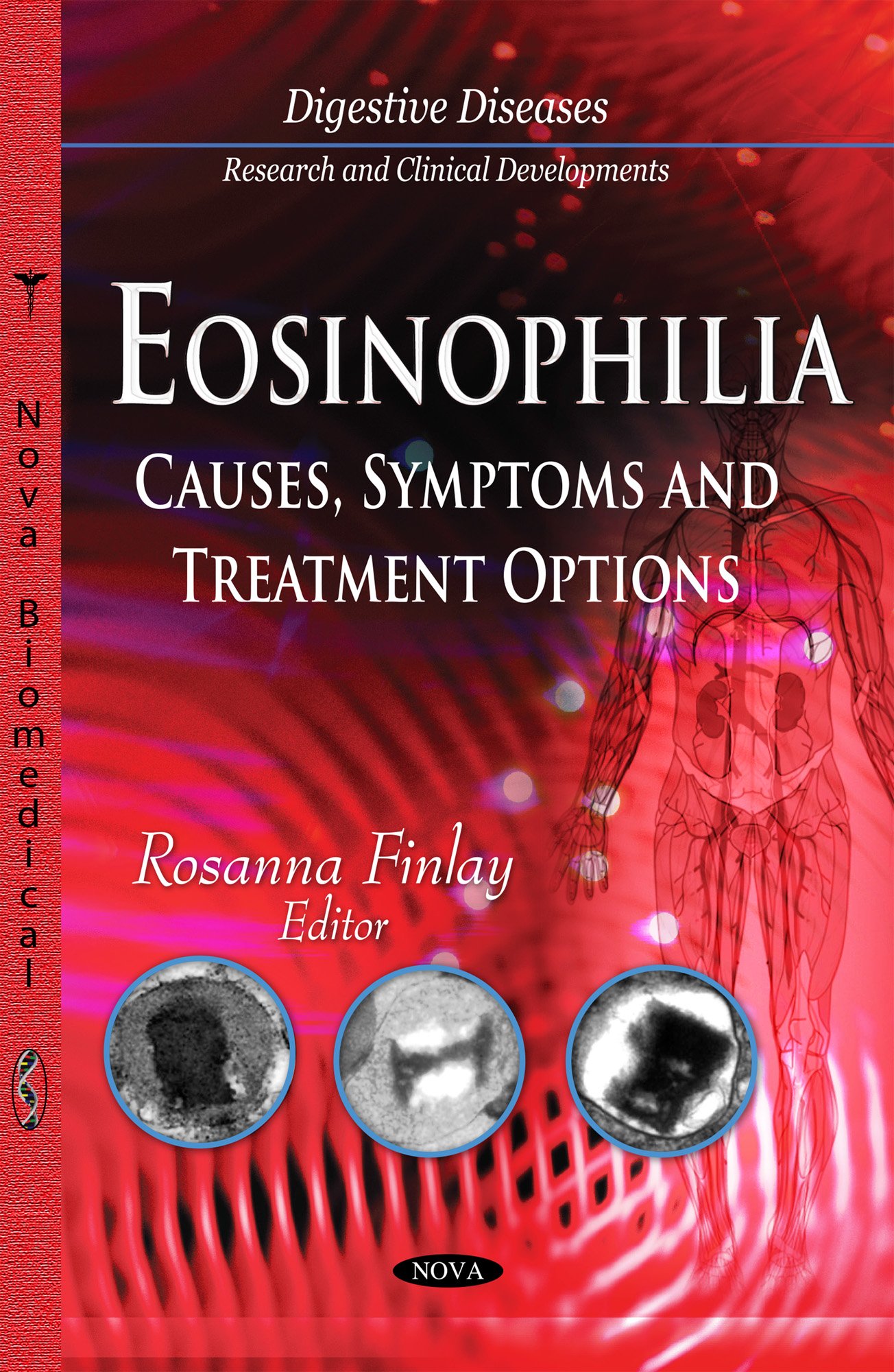 Eosinophilia Symptoms Biological Agent Successfully Treats