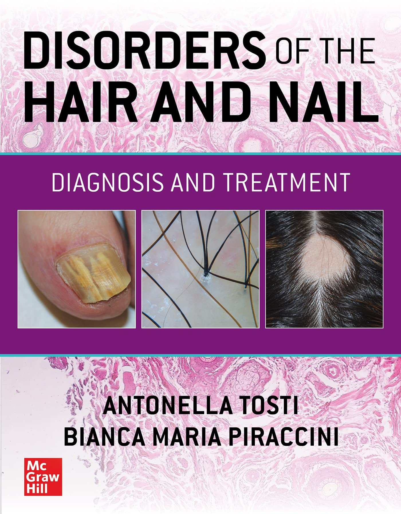 Disorders of the Hair and Nail: Diagnosis and Treatment: 9781260462470 ...