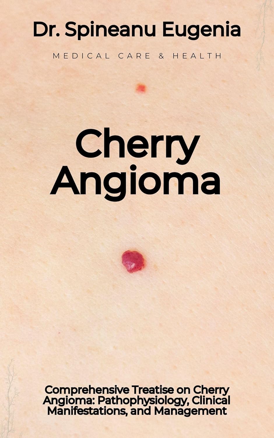 Comprehensive Treatise on Cherry Angioma: Pathophysiology, Clinical ...