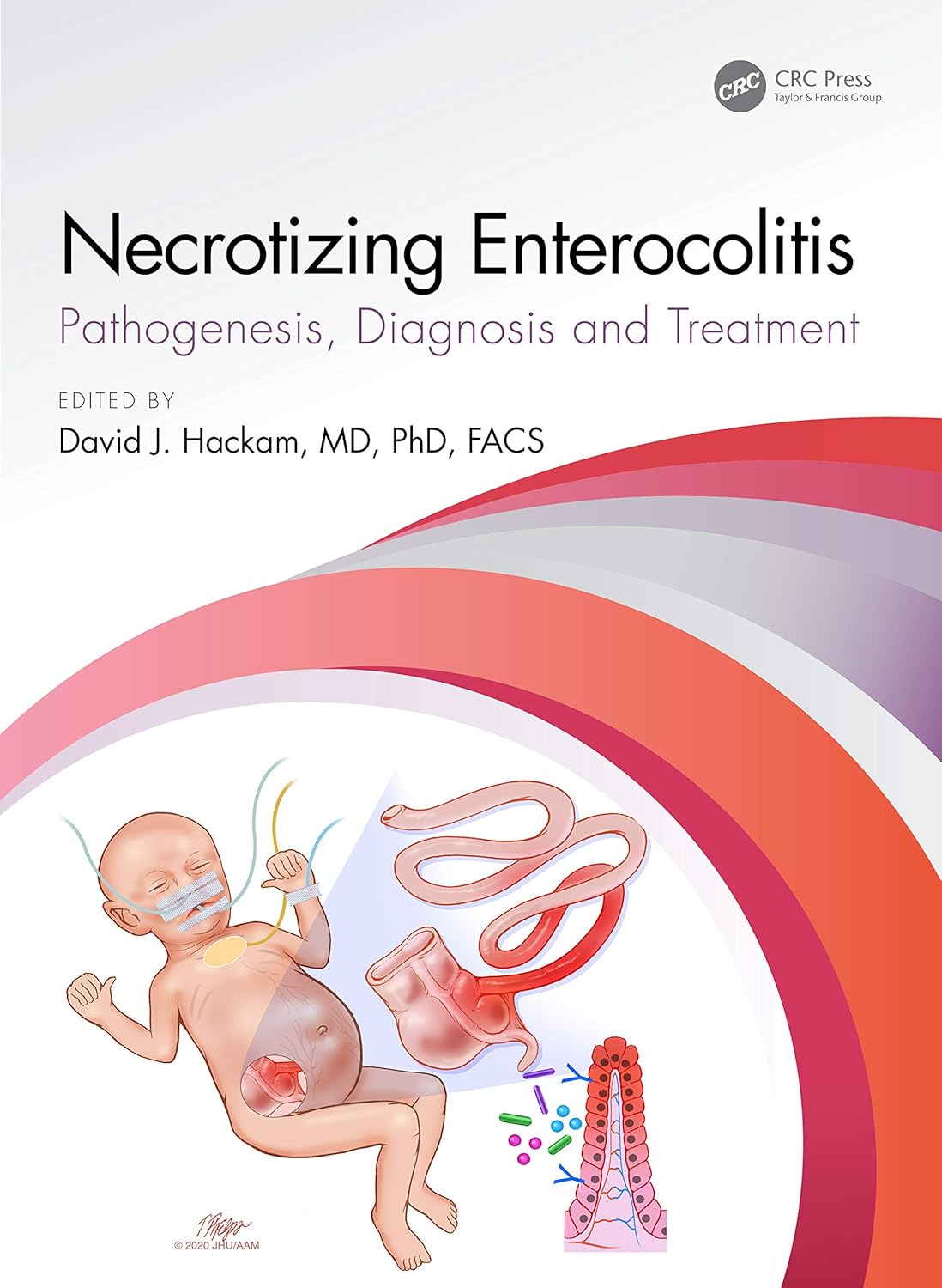 Necrotizing Enterocolitis: pathogenesis, diagnosis and treatment ...