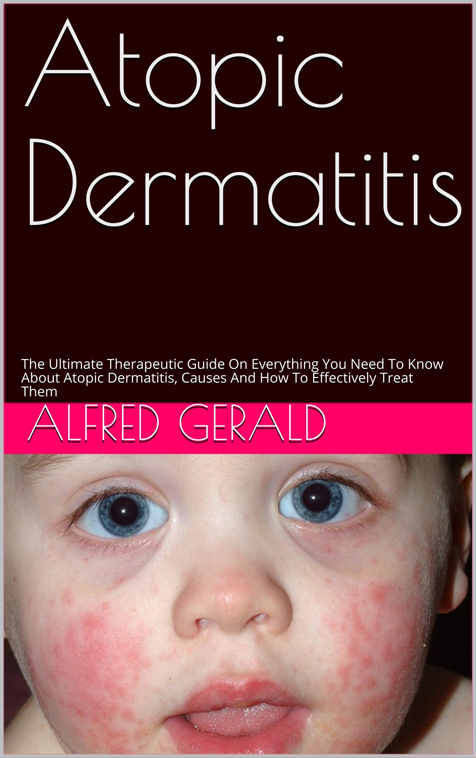 Buy Atopic Dermatitis: The Ultimate Therapeutic Guide On Everything You ...