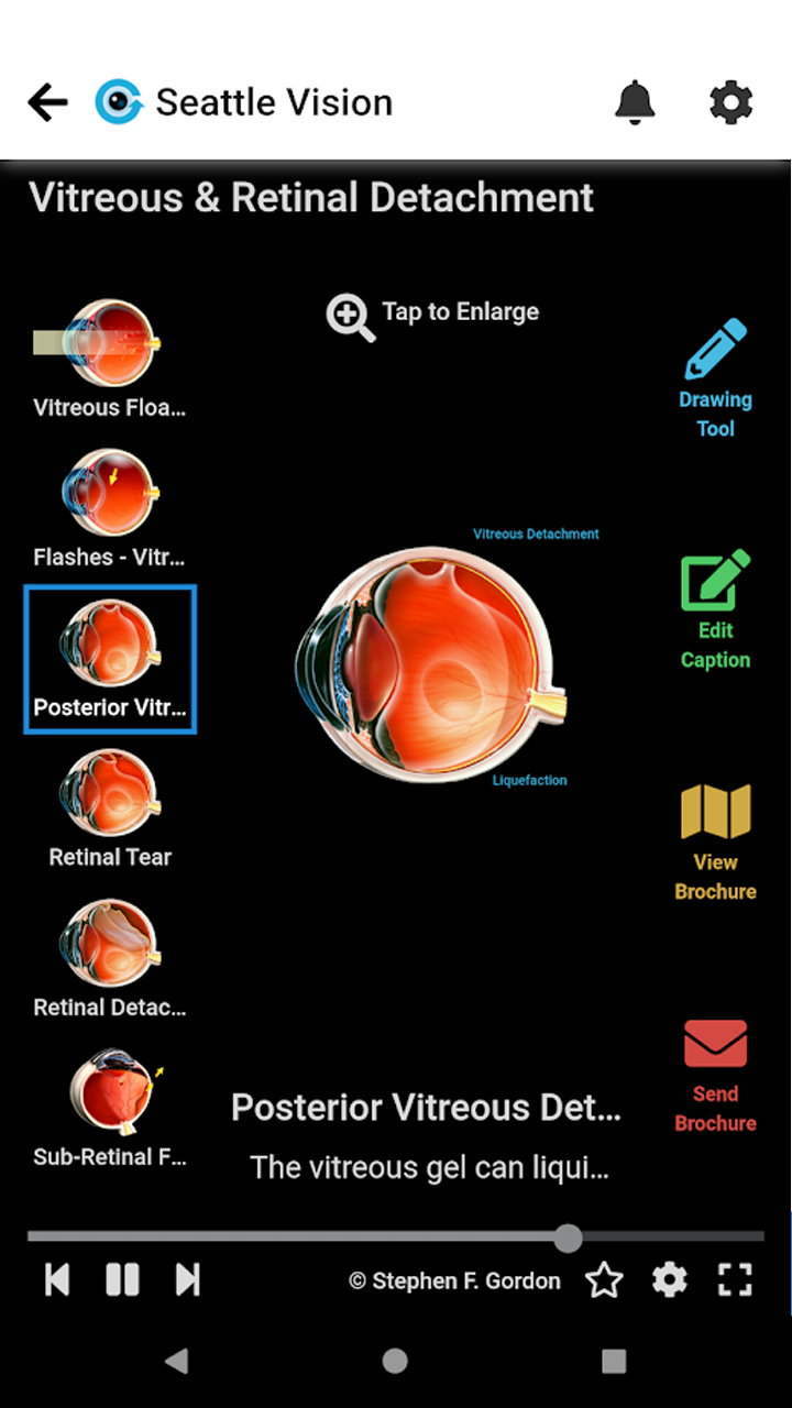 Eye GIFs - Ophthalmic & Eye Care Patient Education - App on Amazon Appstore
