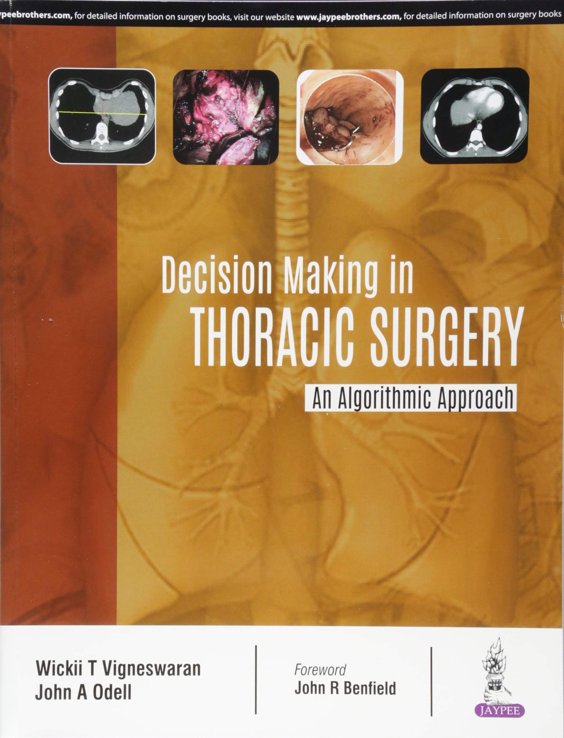 Decision Making in Thoracic Surgery: 9789352700387: Medicine & Health ...