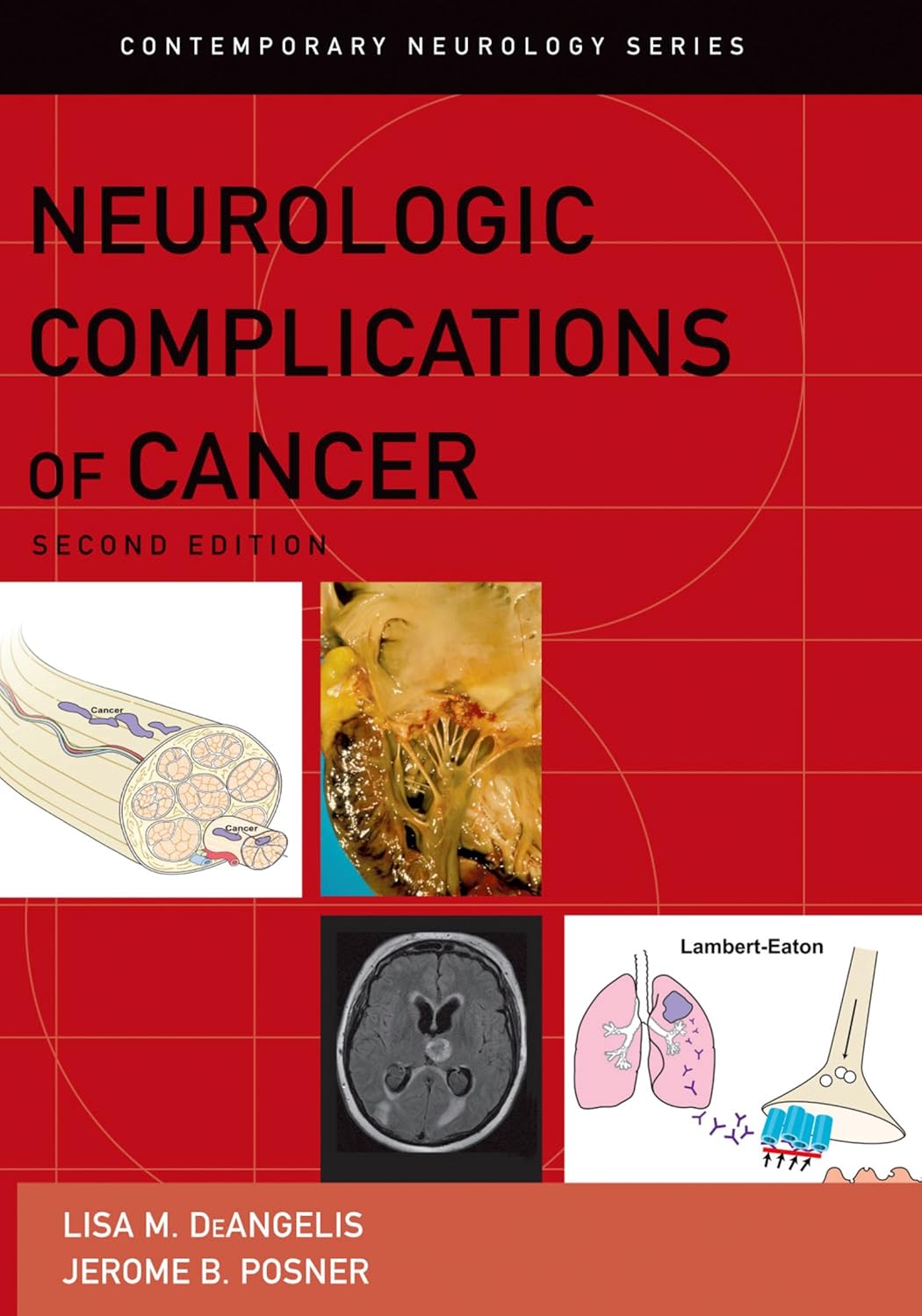 Amazon.com: Neurologic Complications of Cancer (Contemporary Neurology ...
