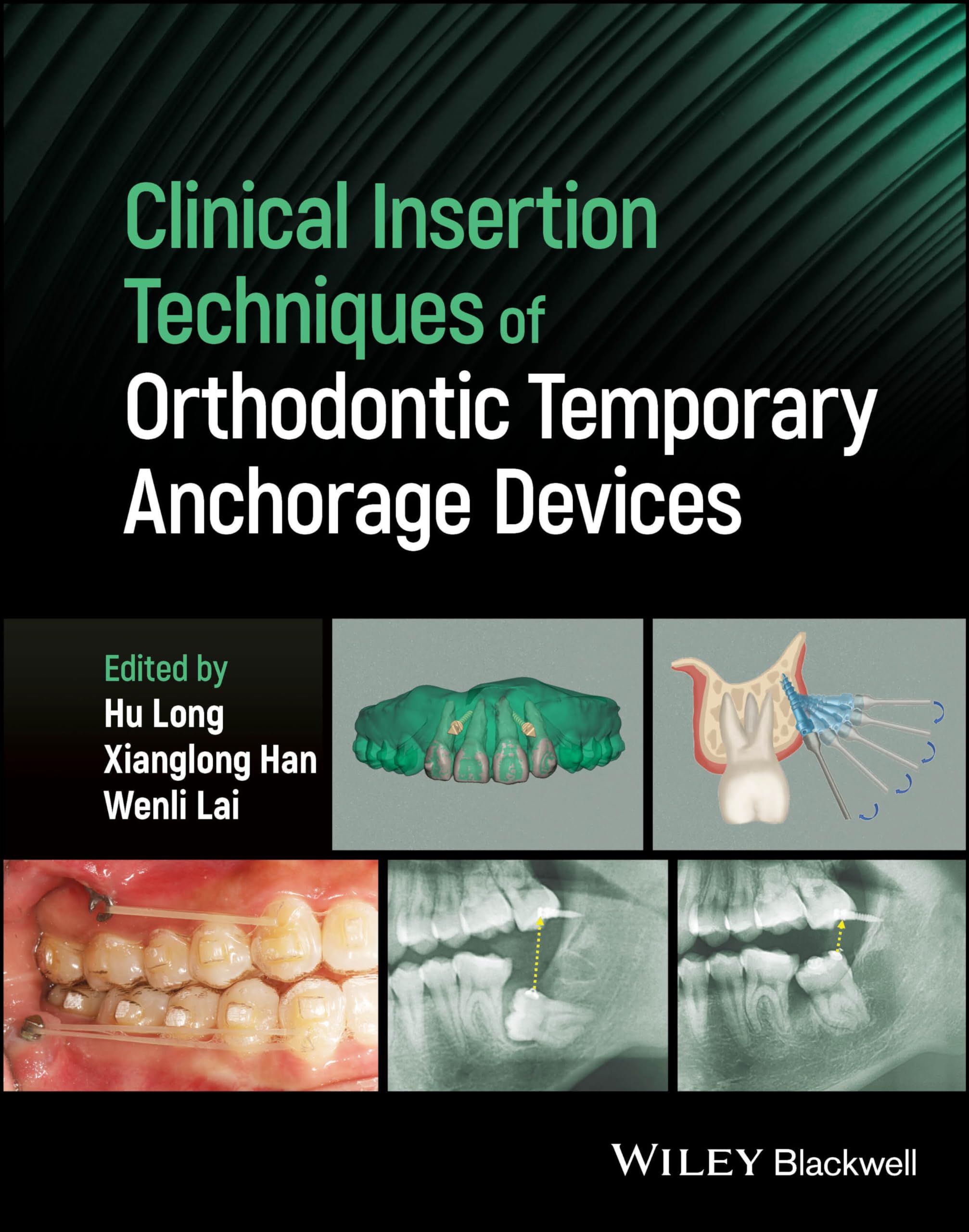 Clinical Insertion Techniques of Orthodontic Temporary Anchorage ...