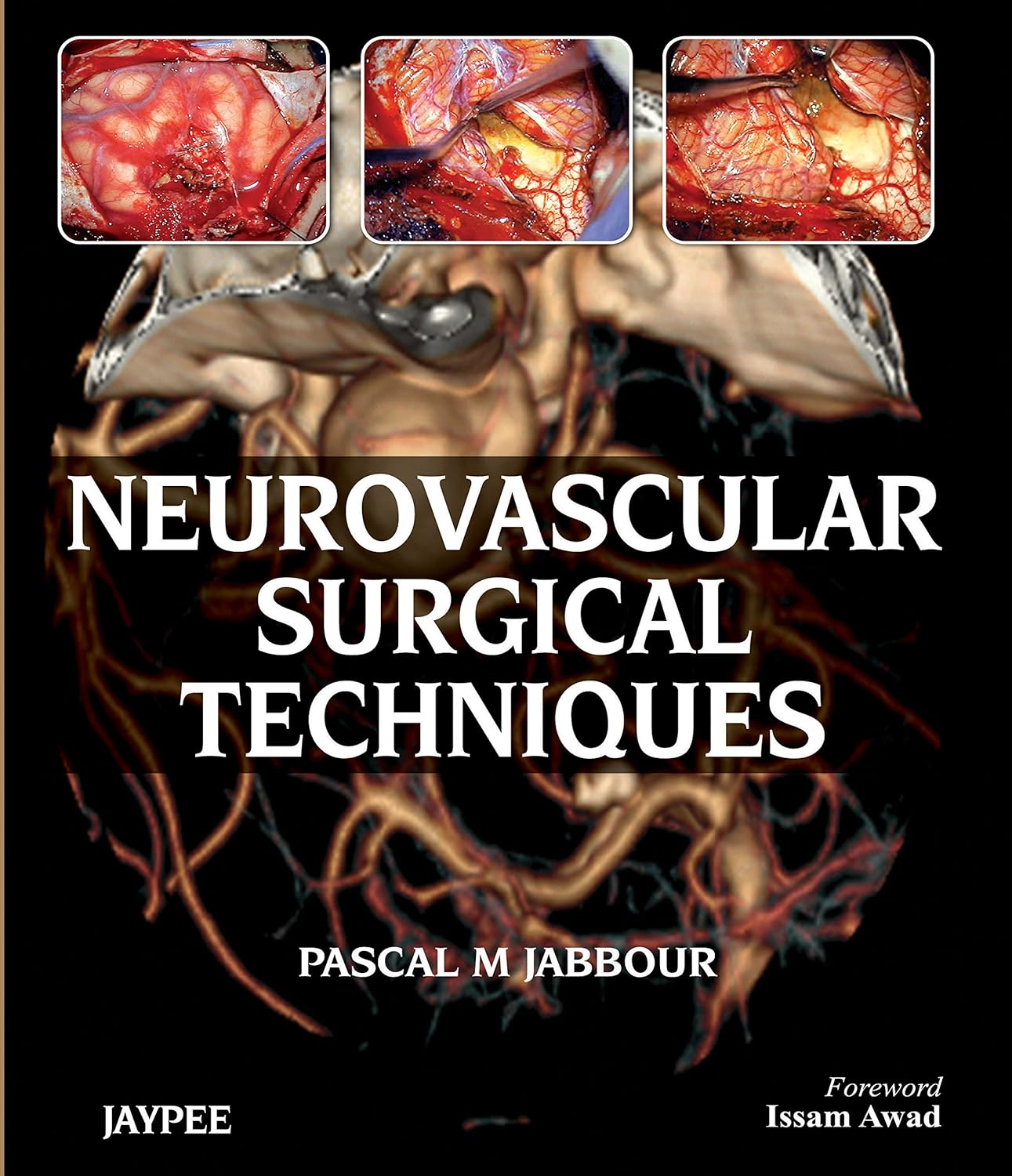 Amazon.com: Neurovascular Surgical Techniques eBook : Jabbour, Pascal M ...