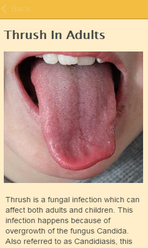 Symptoms Of Thrush - App on the Amazon Appstore